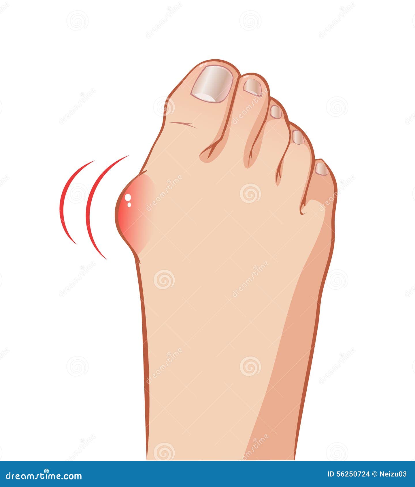Bunion Cartoons, Illustrations & Vector Stock Images - 239 Pictures to ...