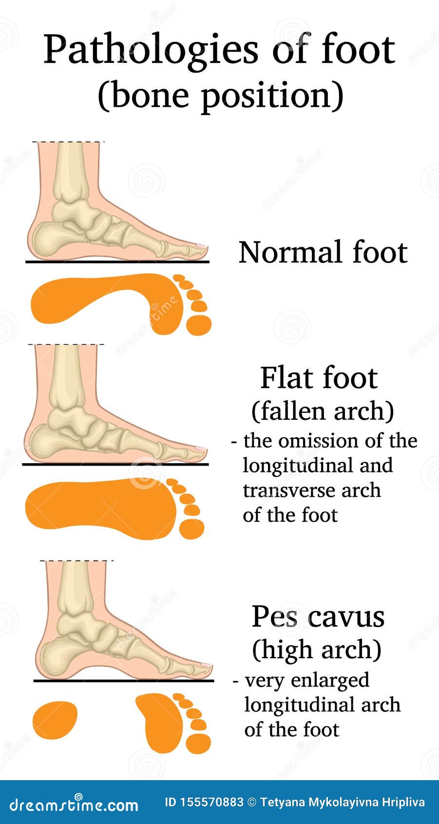 Foot With Pathologies. Fungal Lesions Of The Foot, Nails And Skin ...
