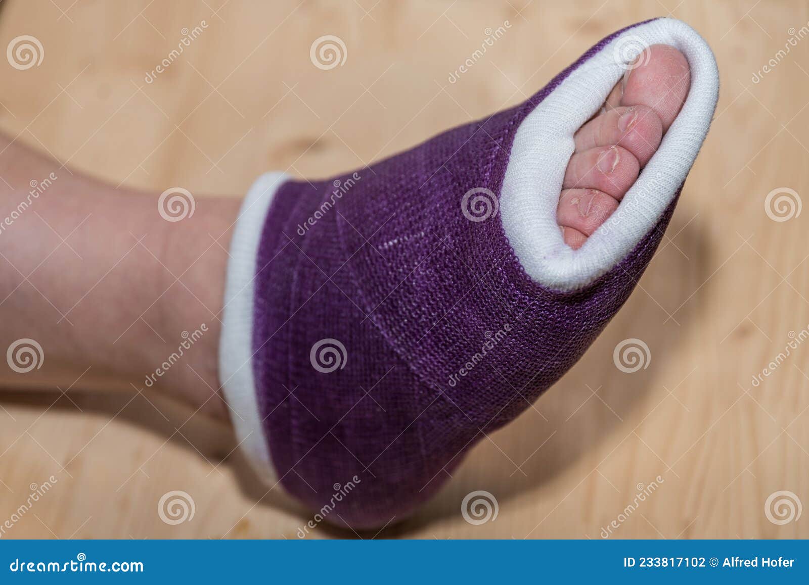 Foot with Plaster Cast - Close-up Stock Photo - Image of disabled ...