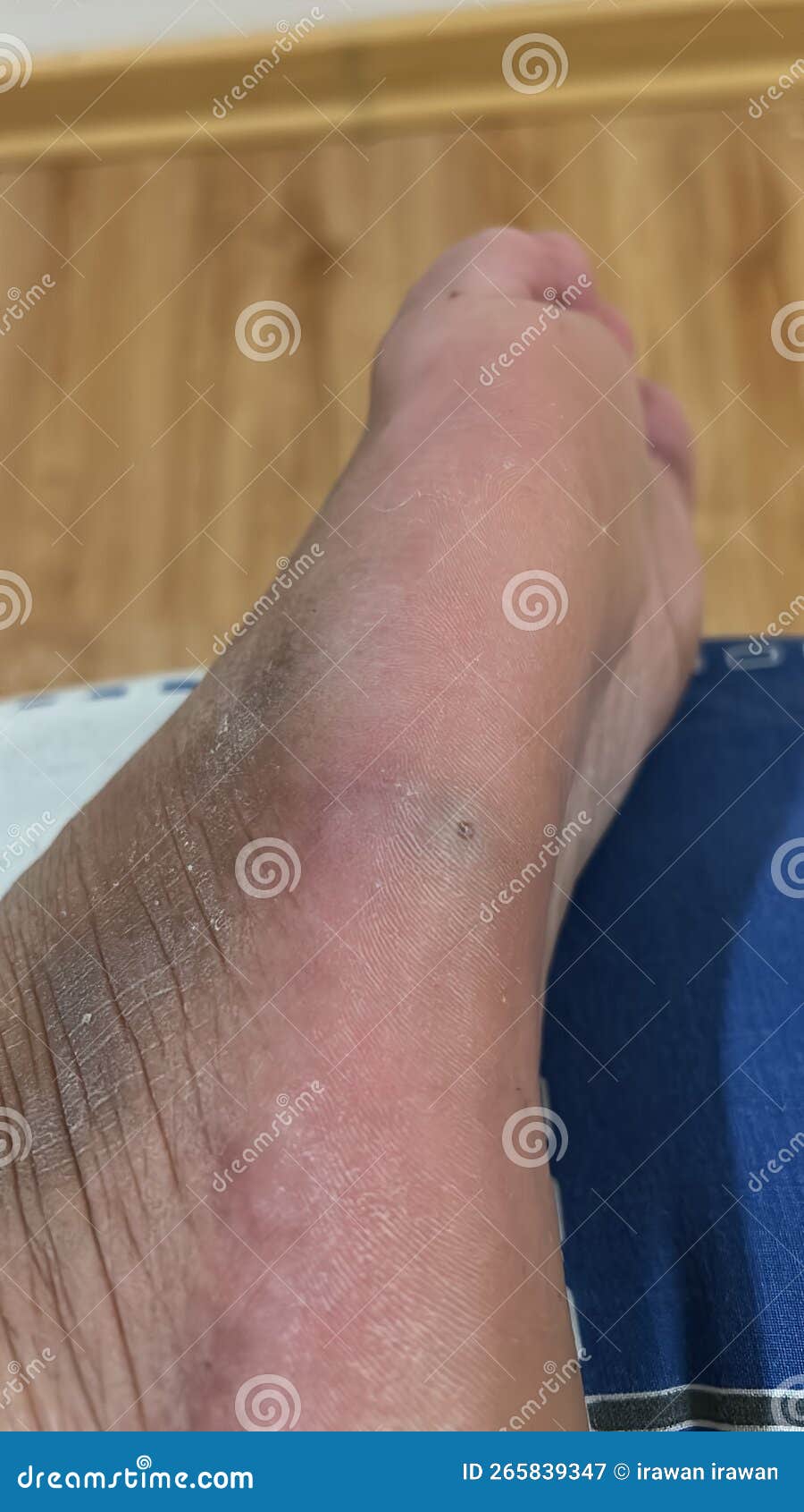 Foot stock image. Image of wound, surgery, minor, foot - 265839347