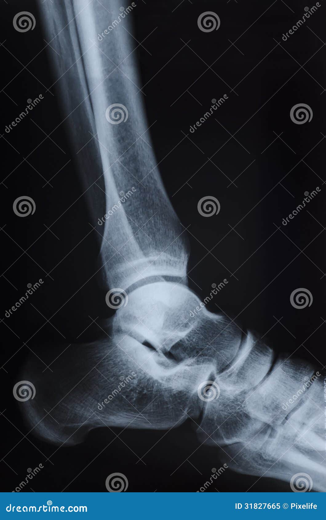 Foot x-ray stock image. Image of external, anatomy, healthcare - 31827665