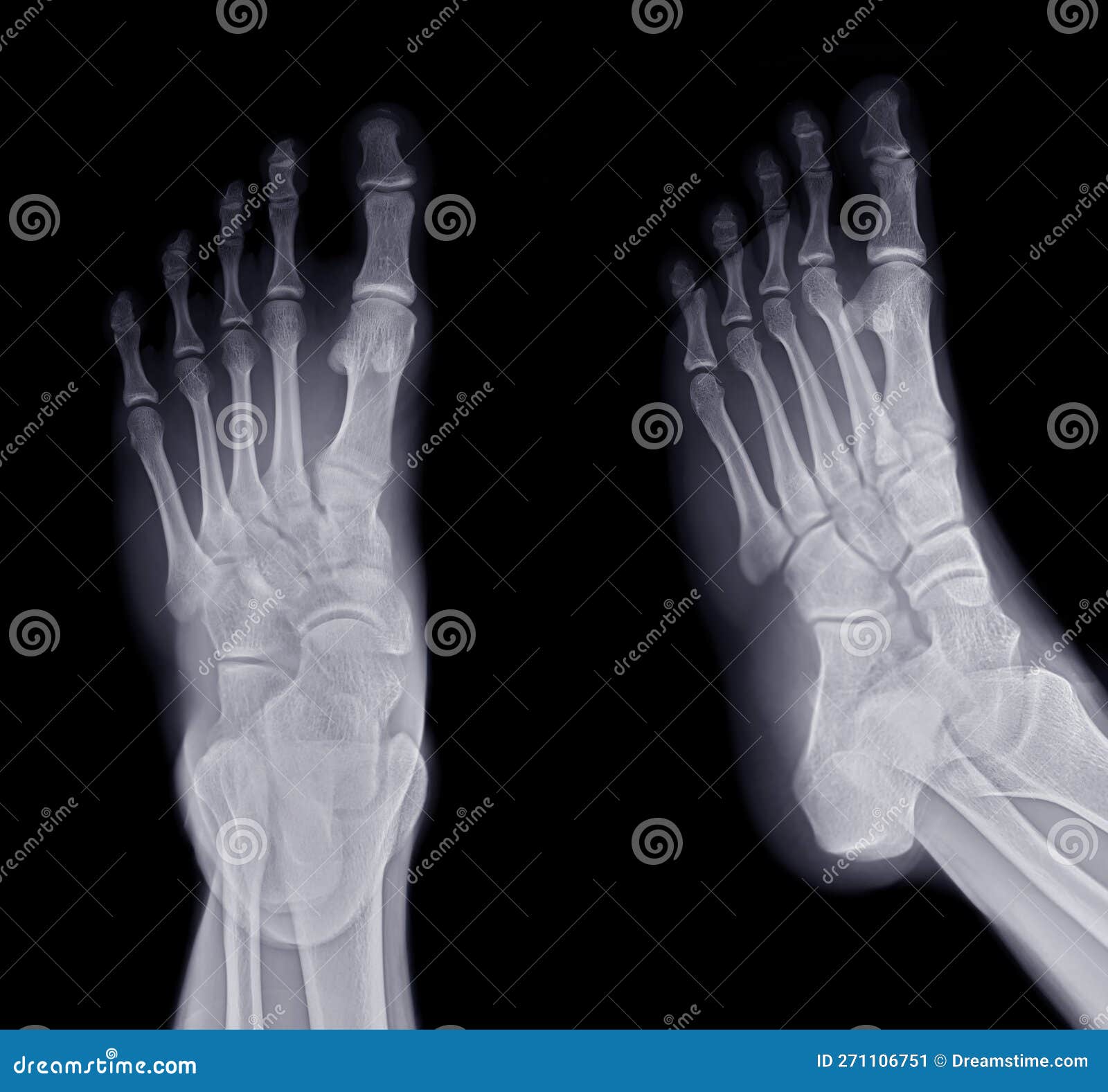 Foot X Ray Image Ap And Oblique View Isolated On Black Background Stock