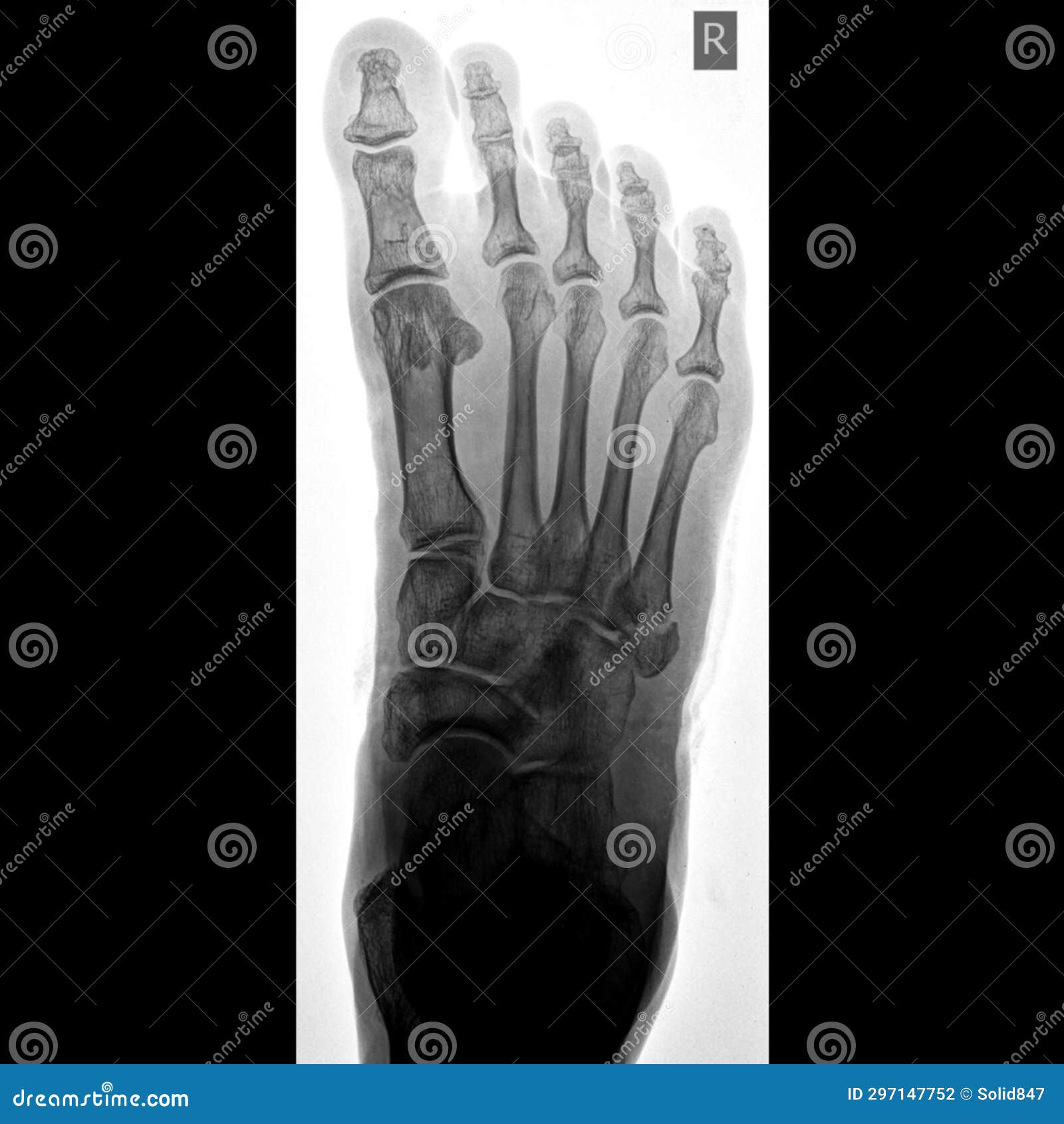 Foot X-ray Image Ap View on Isolated White Background Stock Photo ...