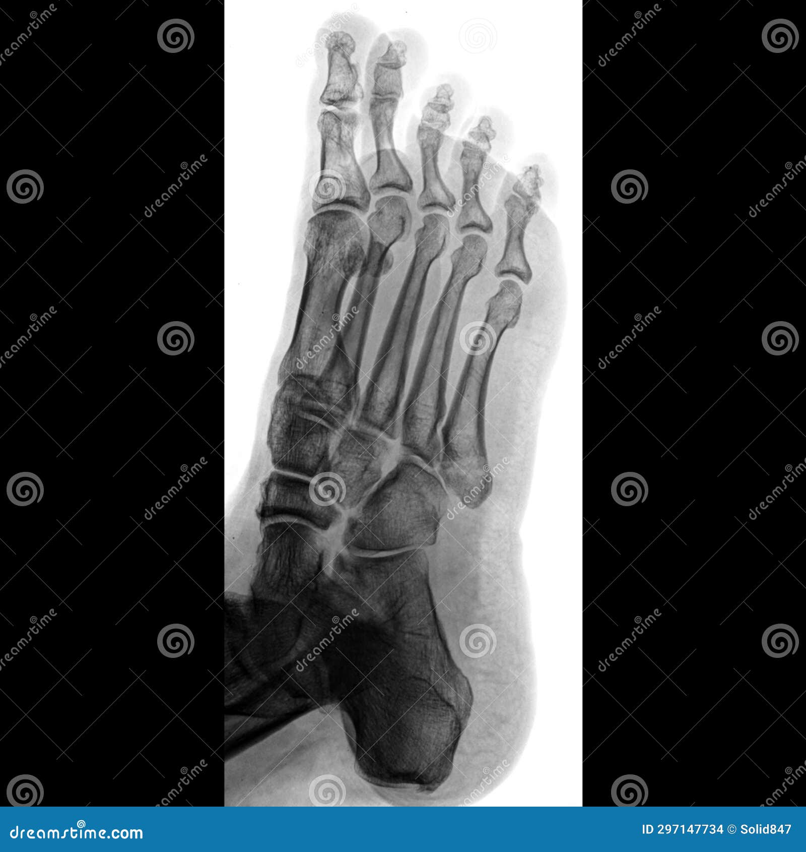 Foot Anatomy X Ray Oblique at Spencer Leschen blog