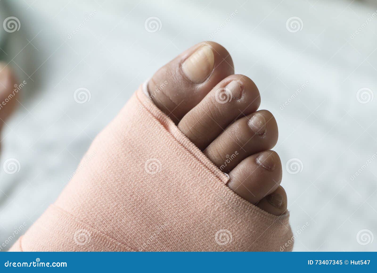 Foot Soft Splint for Treatment of Injuries Stock Image - Image of ...