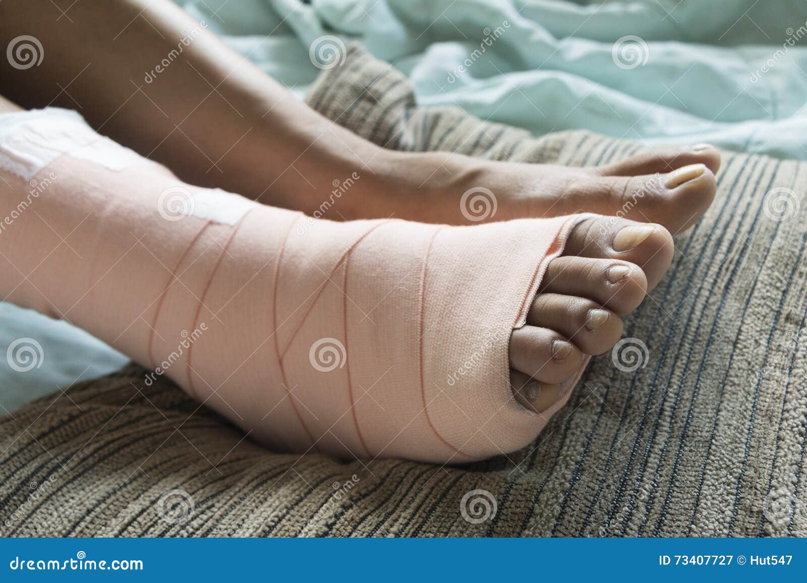 Foot Soft Splint for Treatment of Injuries Stock Image - Image of ...