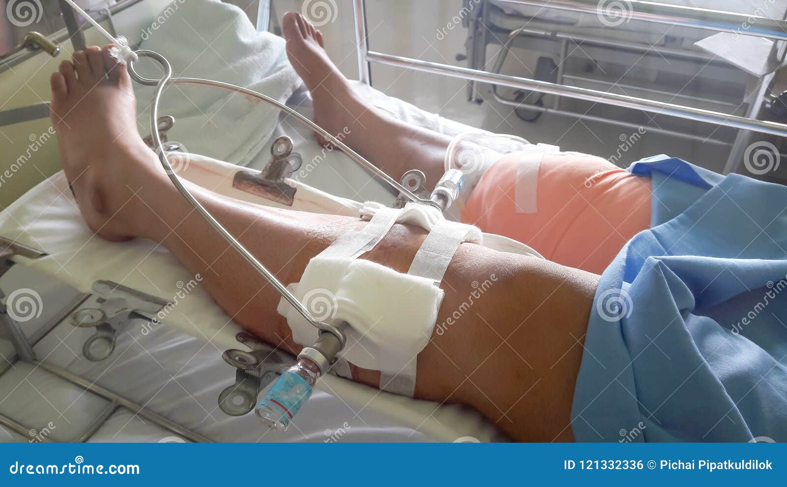 Foot Splint with Iron on Leg Stock Photo - Image of injury, cast: 121332336