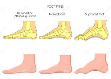 Foot types stock vector. Illustration of medicine, longitudial - 75016129