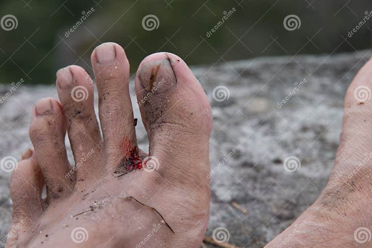 Foot ulcers with a blood stock image. Image of patient - 64406947