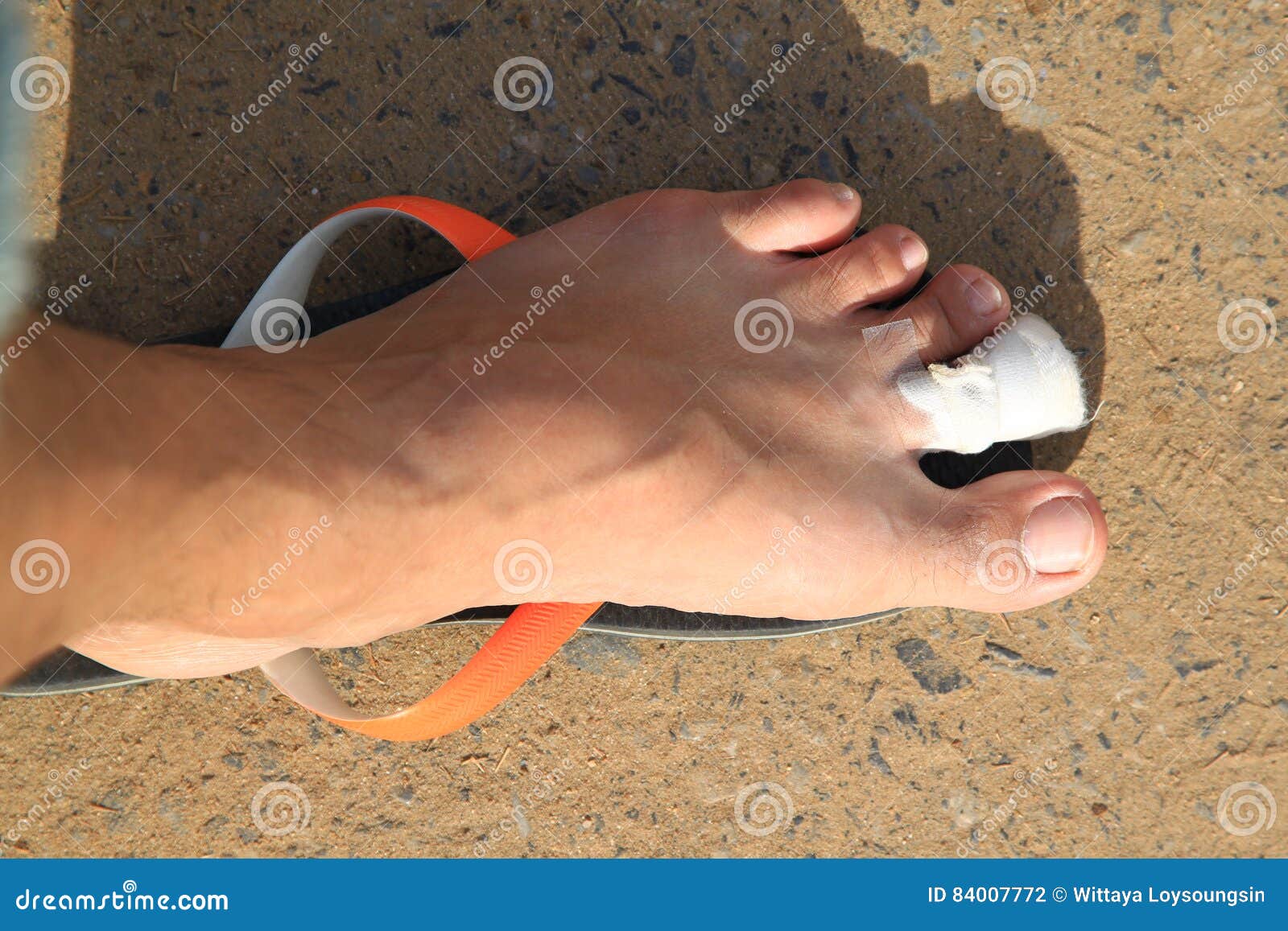 Foot Ulcers, Nail Trauma, Onychocryptosis Royalty-Free Stock Photo ...