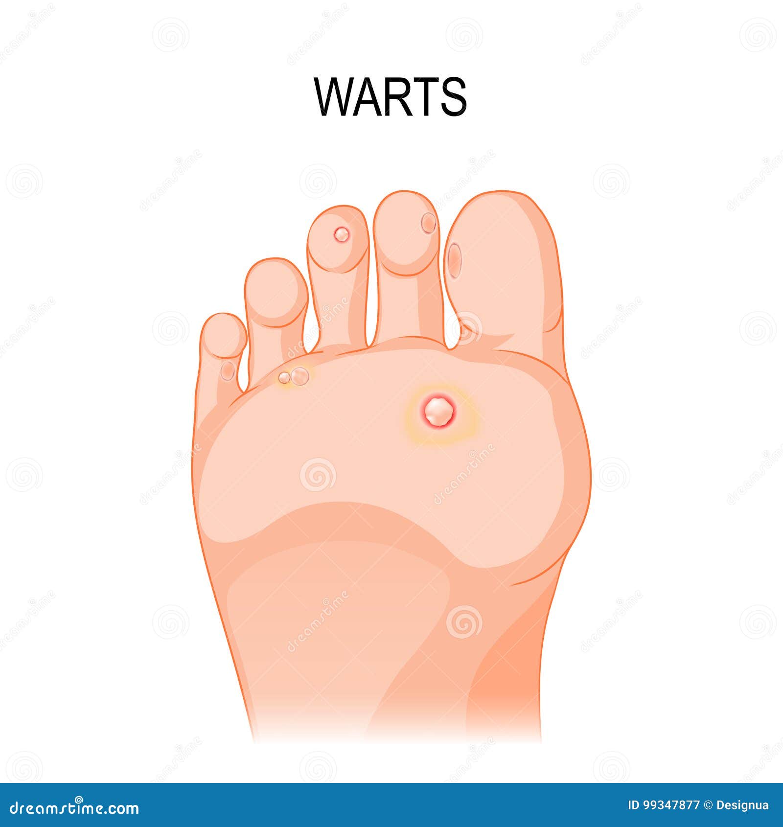 Plantar Wart Vector Illustration | CartoonDealer.com #29067164