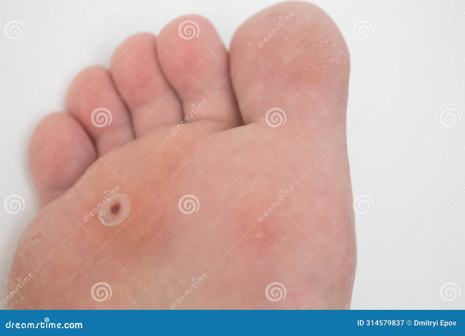 Foot with Wart on a Toe. Wart Verrucas Plantar Stock Image - Image of ...