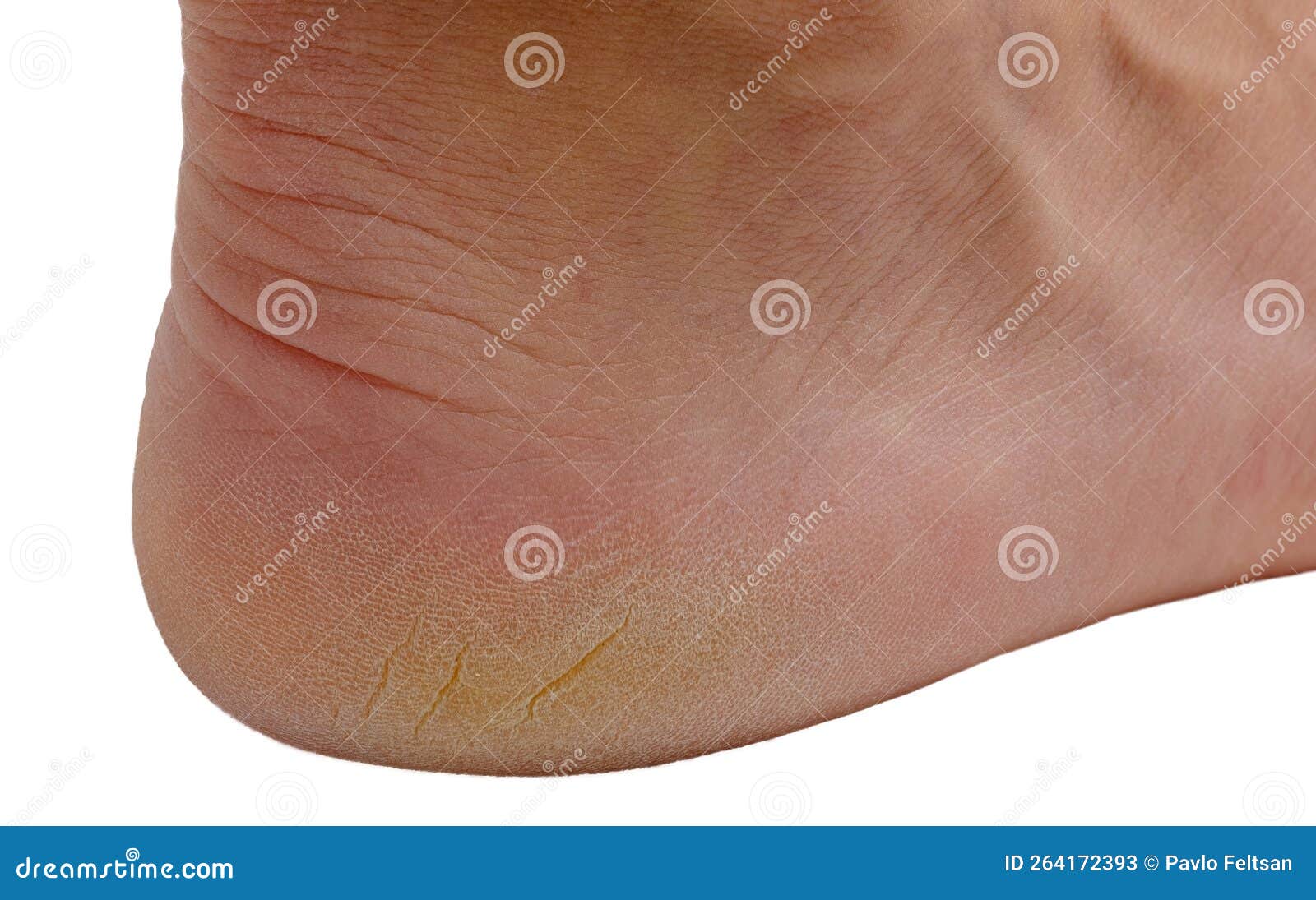 A Foot on the White Background with a Cracked Heel Stock Image - Image ...