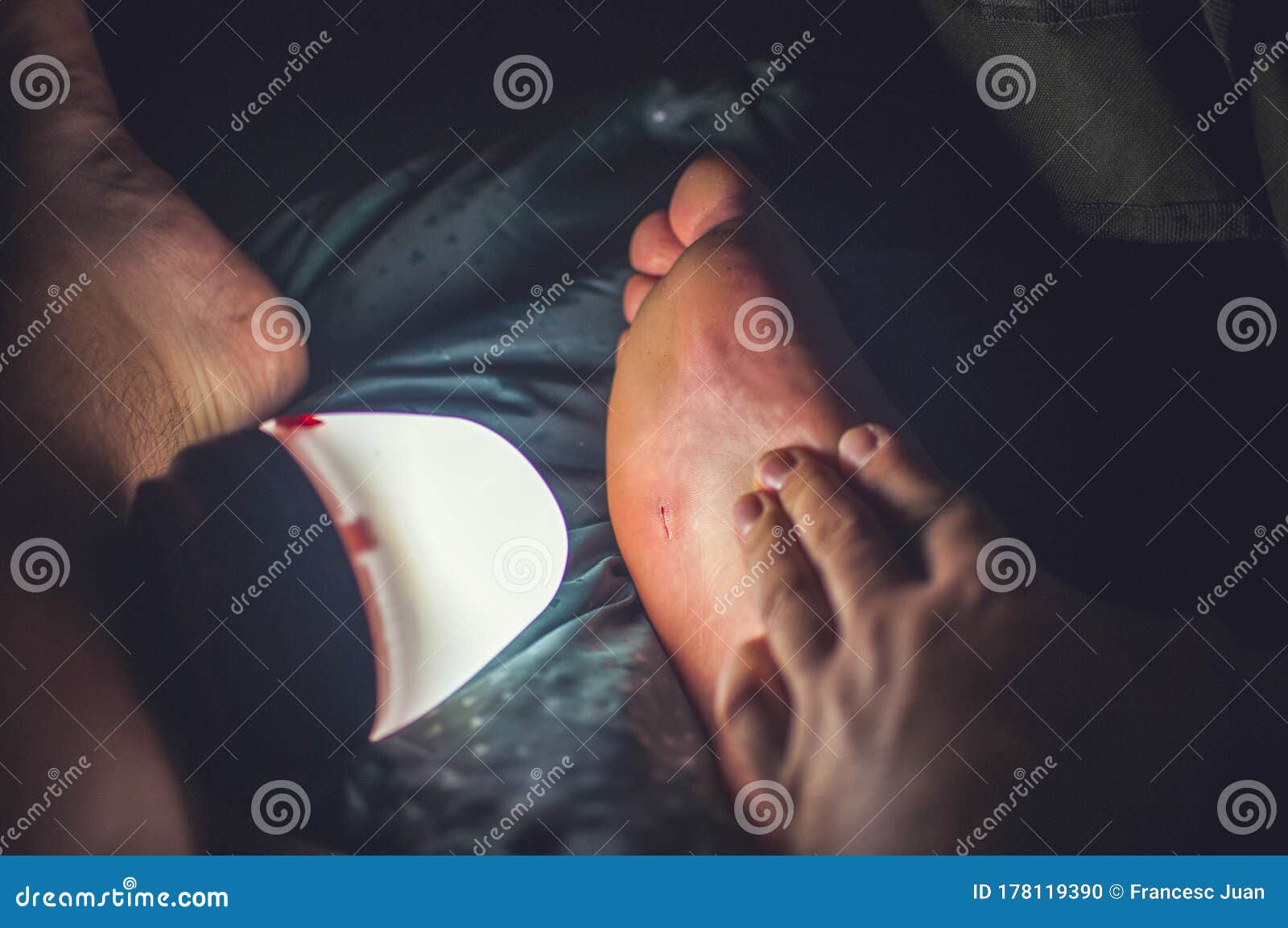 Foot with wound stock photo. Image of healthcare, knee - 178119390