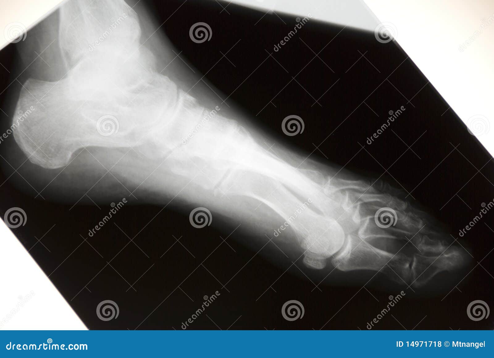 Foot Xray Showing Soft Tissue Gas In Patient With Necrotizing ...