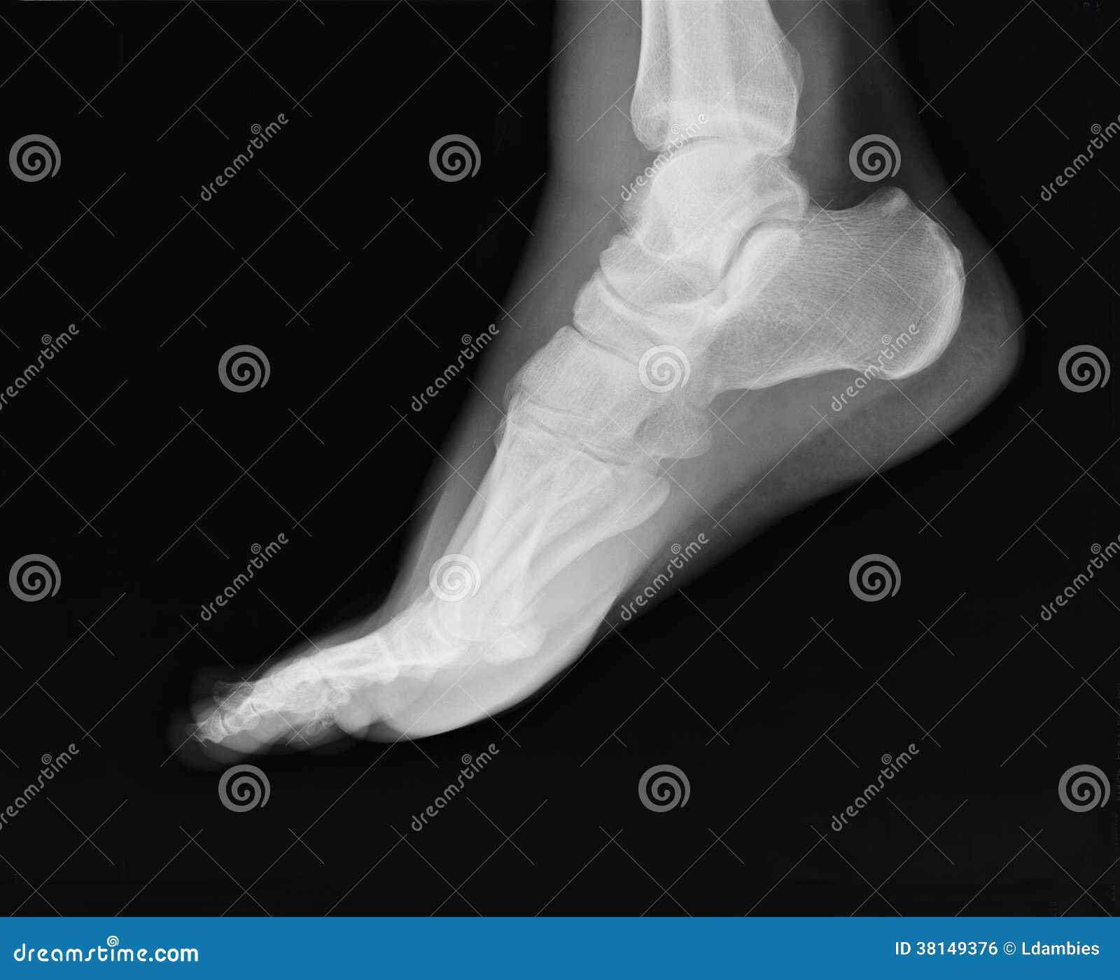 Foot Xray Showing Soft Tissue Gas In Patient With Necrotizing ...