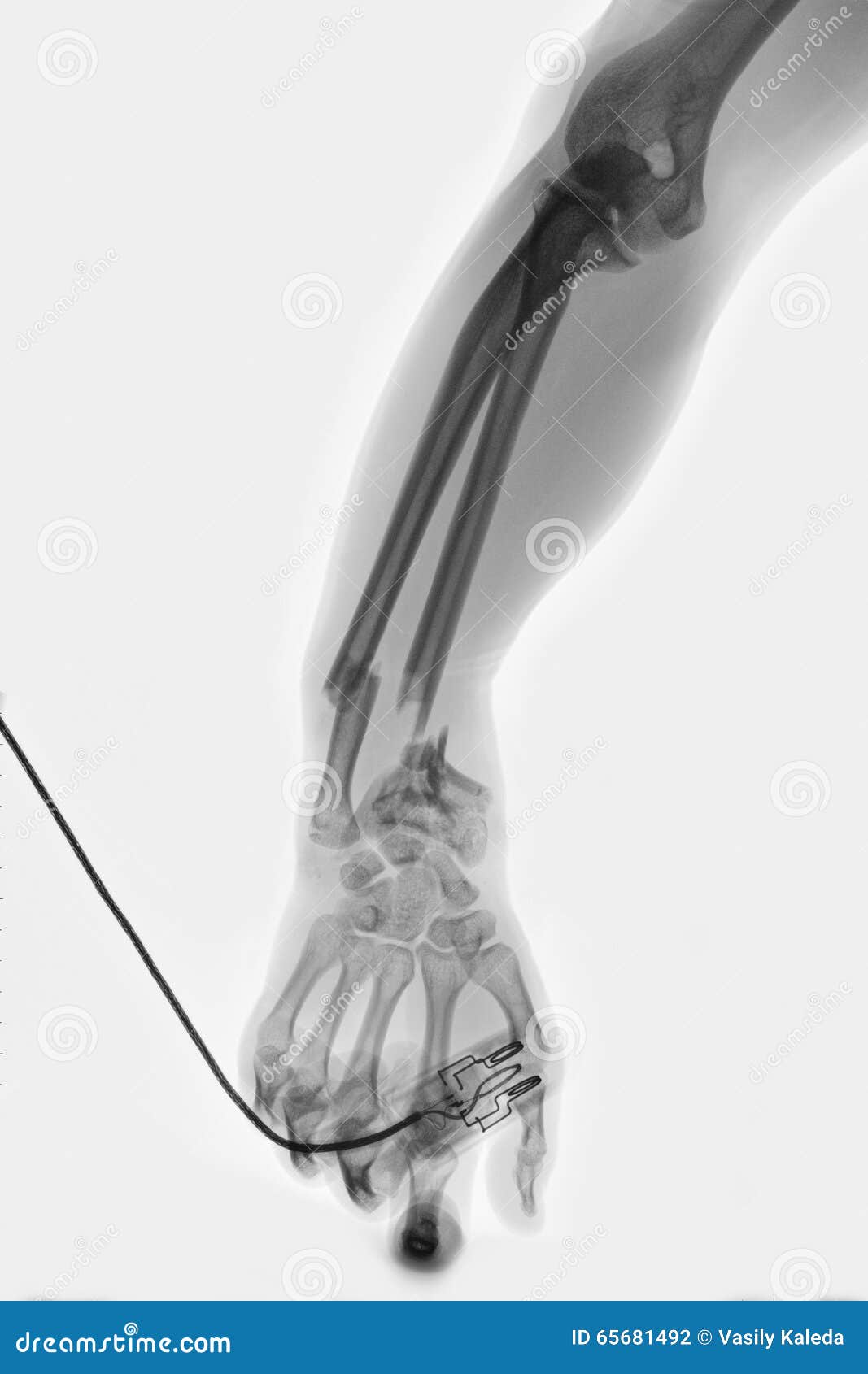 Forearm fracture stock photo. Image of trauma, diagnostic - 65681492