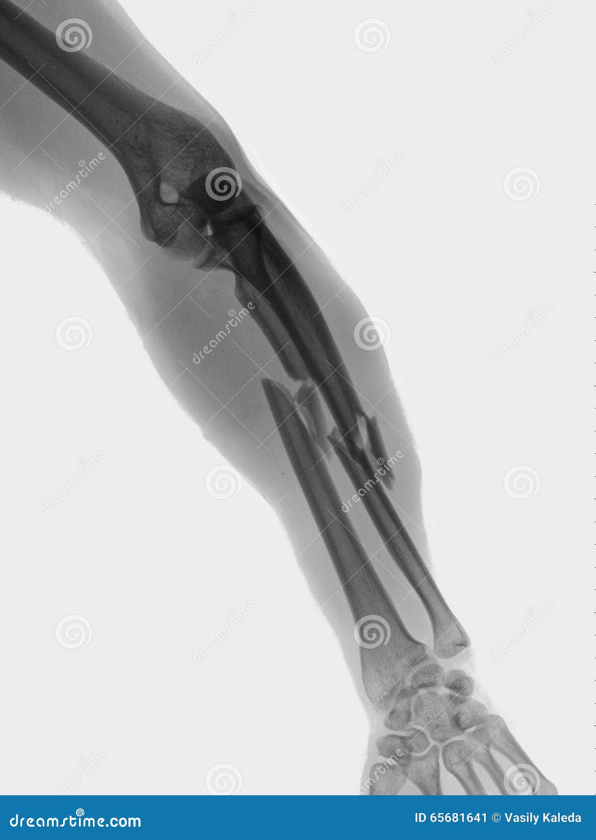 Forearm fracture stock image. Image of surgery, ulna - 65681641