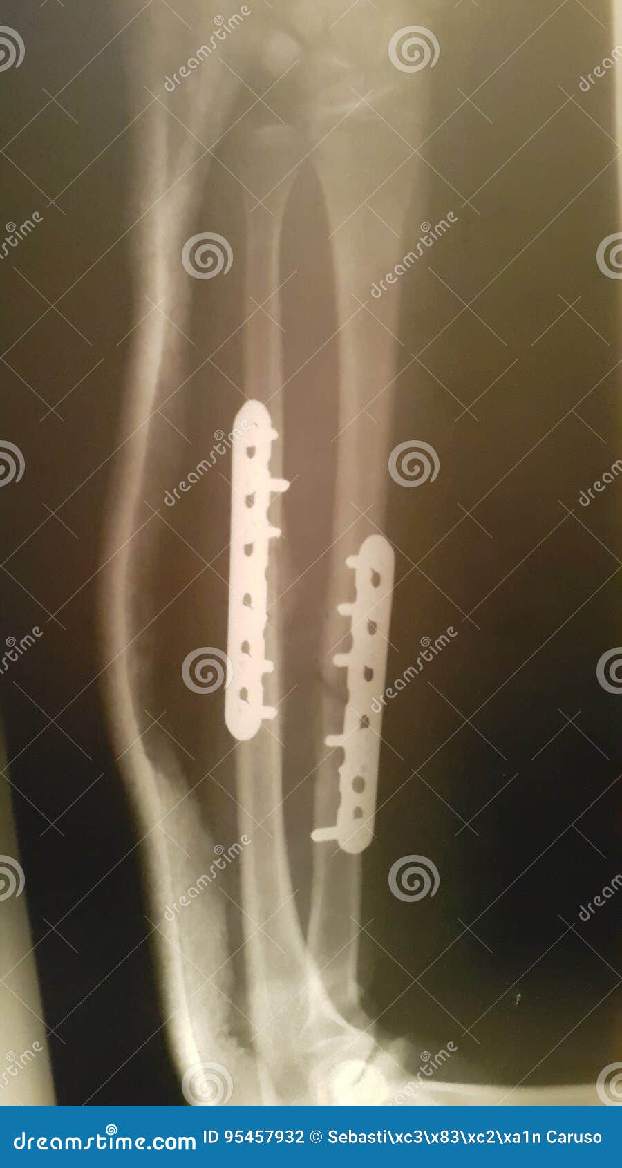 Forearm Surgery stock photo. Image of forearm, osteosynthesis - 95457932