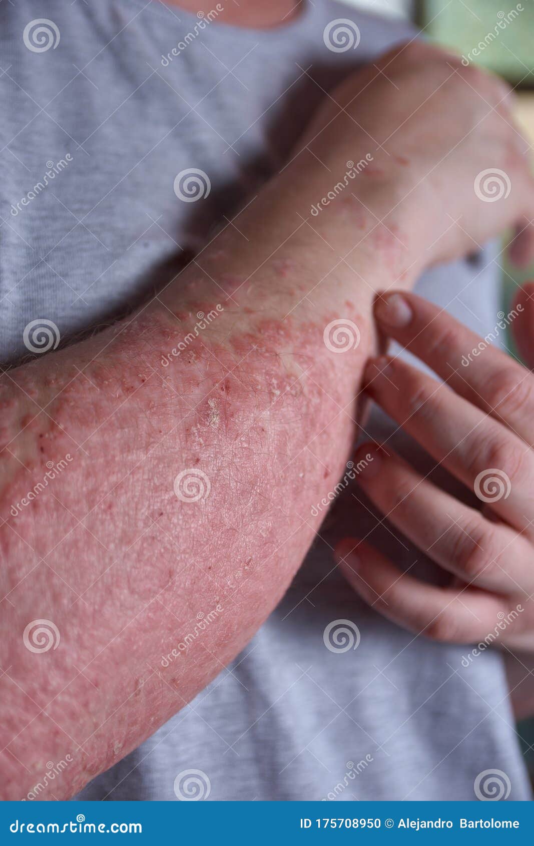 Forearm View with Psoriasis Stock Photo - Image of elbow, immune: 175708950