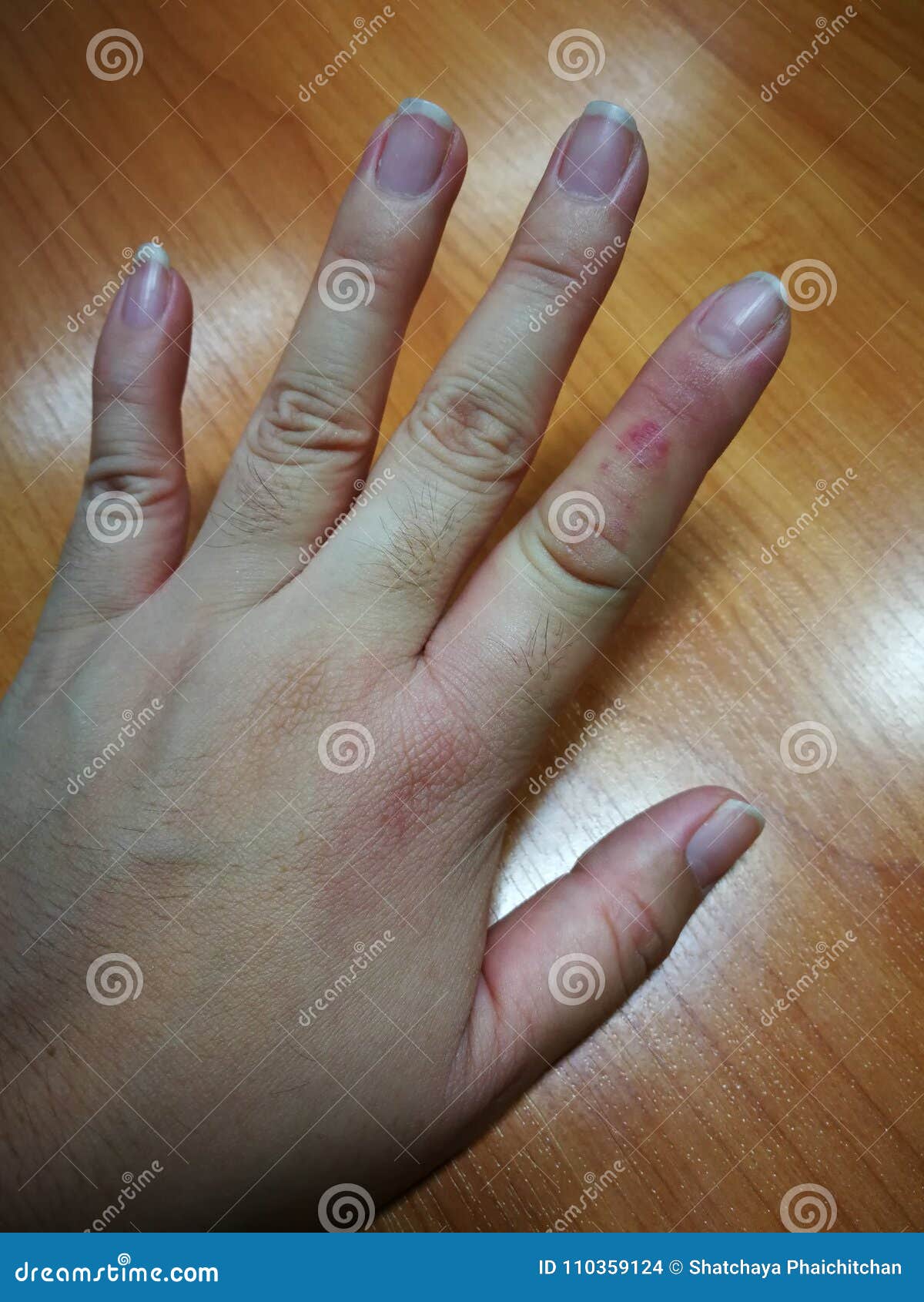 Skin Burns On Human Arm Stock Image | CartoonDealer.com #85499155