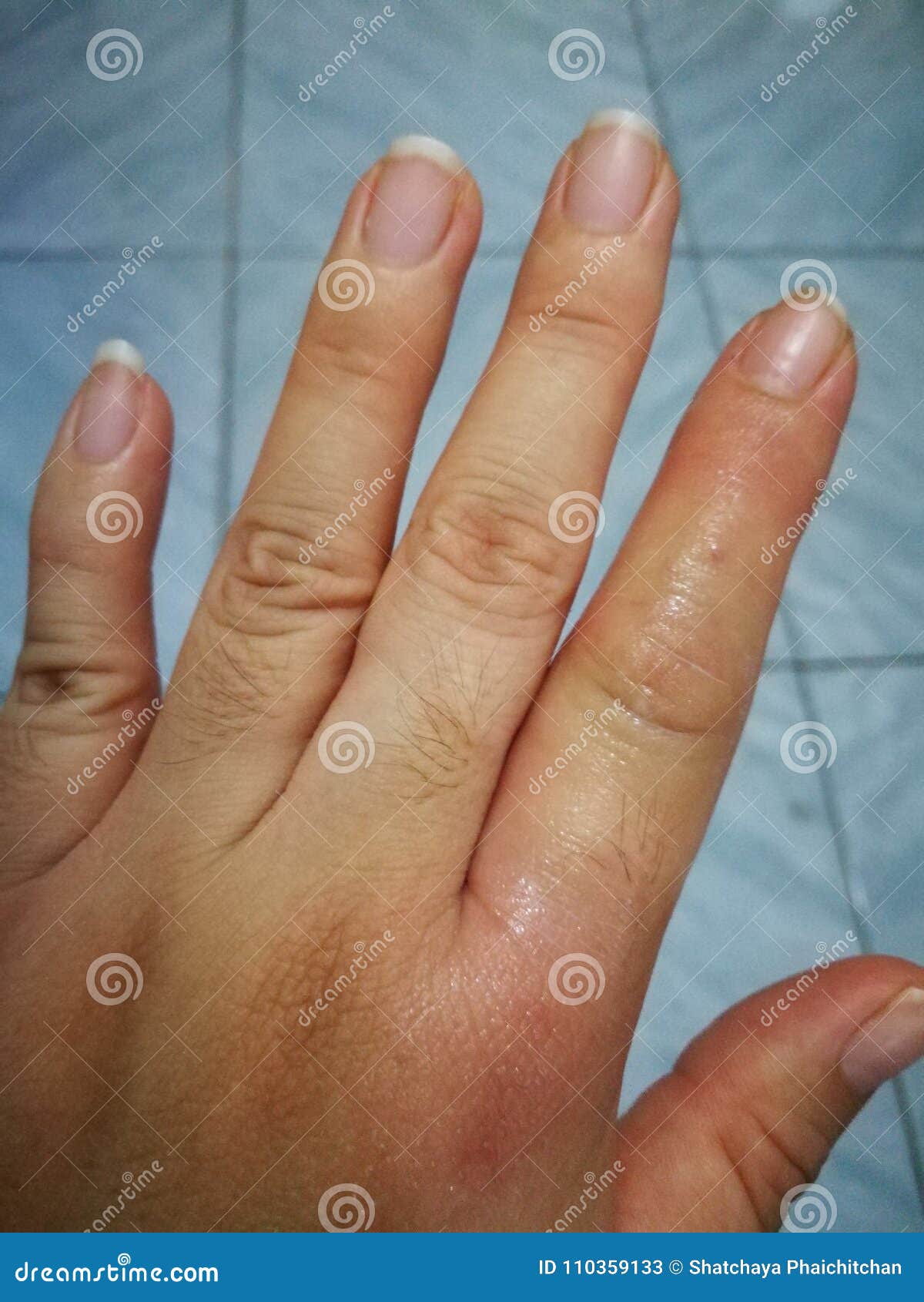 Forefinger Skin burns stock image. Image of nail, love - 110359133