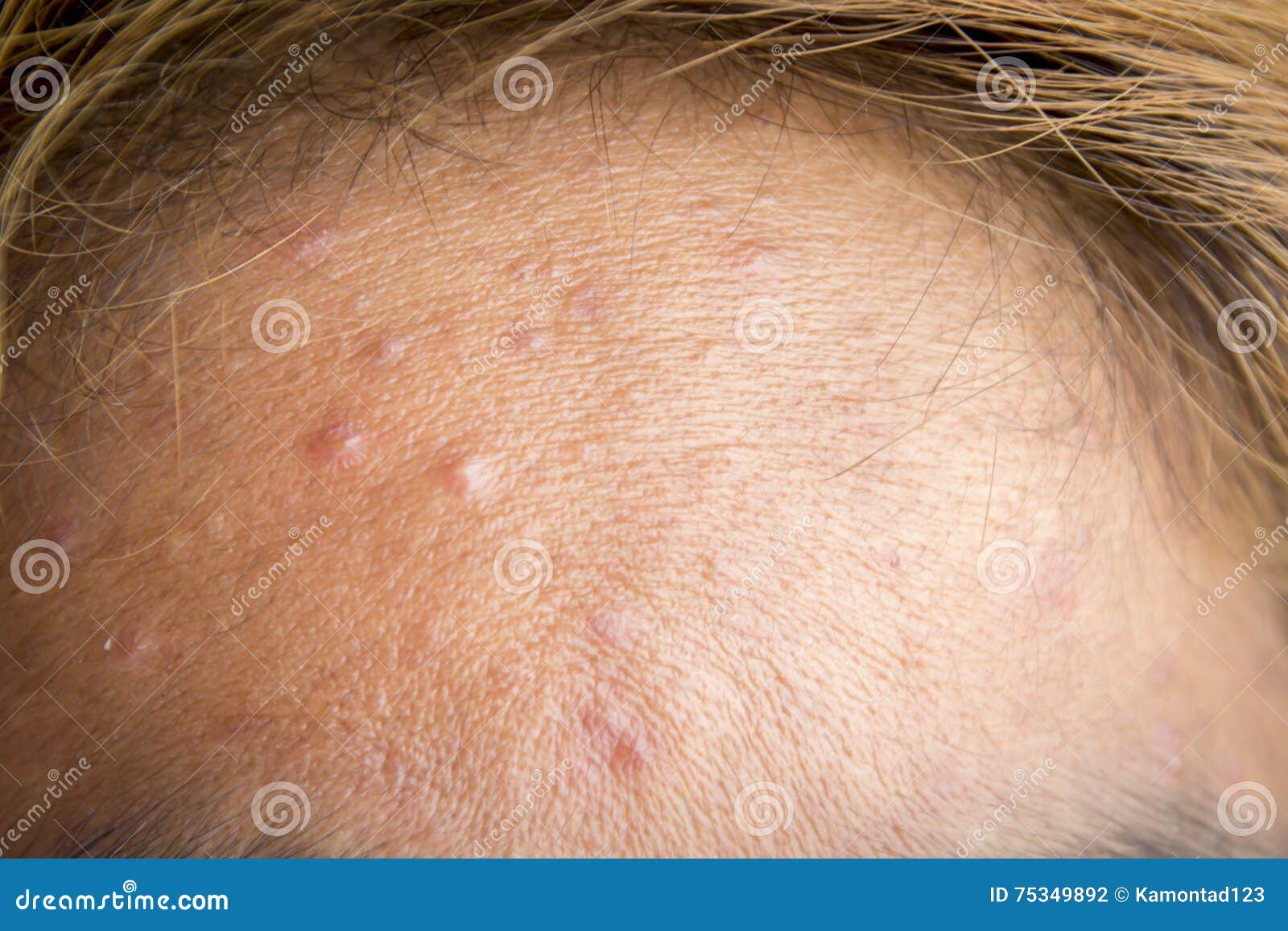 Forehead with Typical Problem with Acne Stock Photo - Image of skincare ...