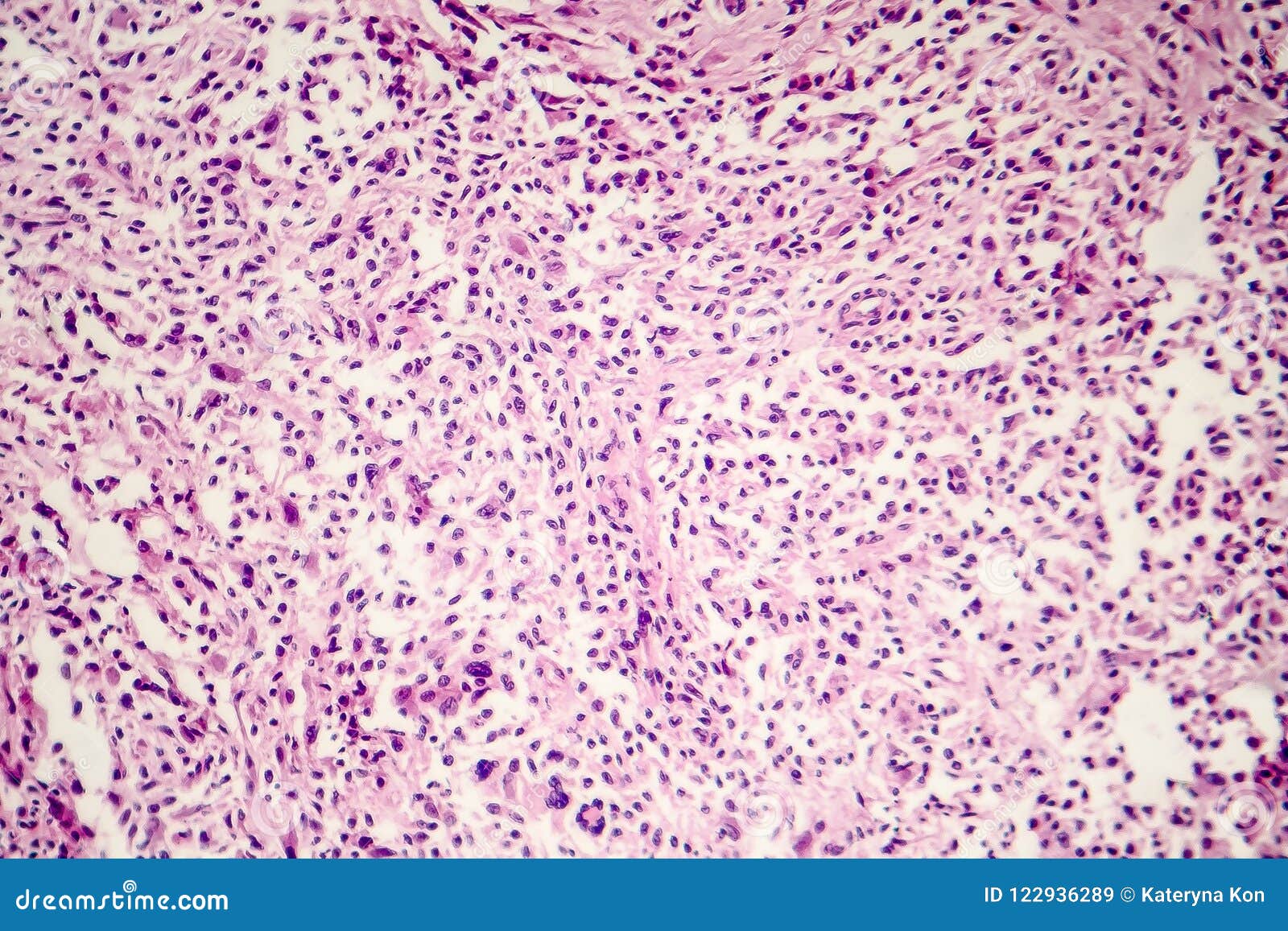 Foreign body granuloma stock image. Image of microphotograph - 122936289