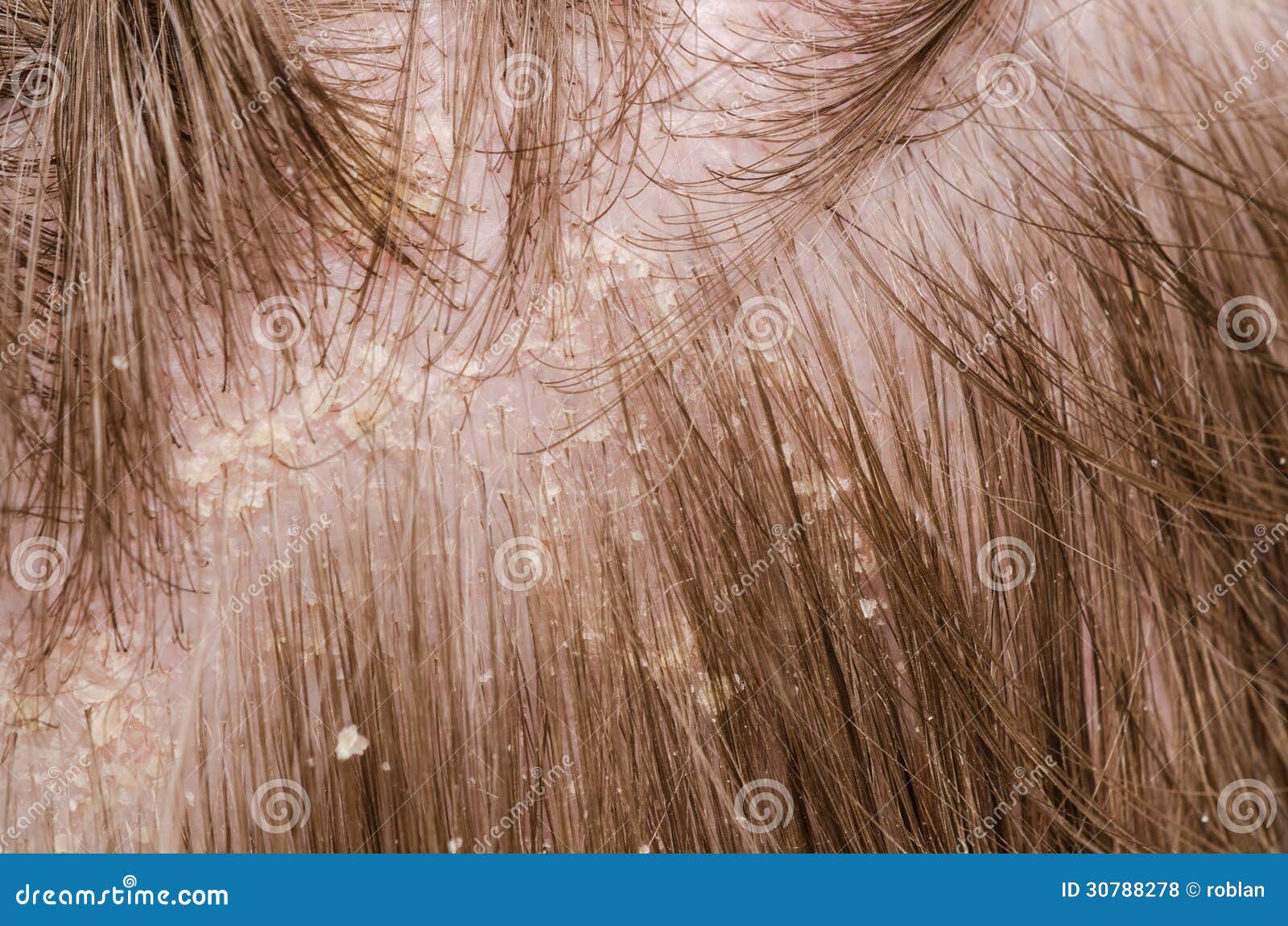 Forfora fotografia stock. Immagine di macro, problema - 30788278