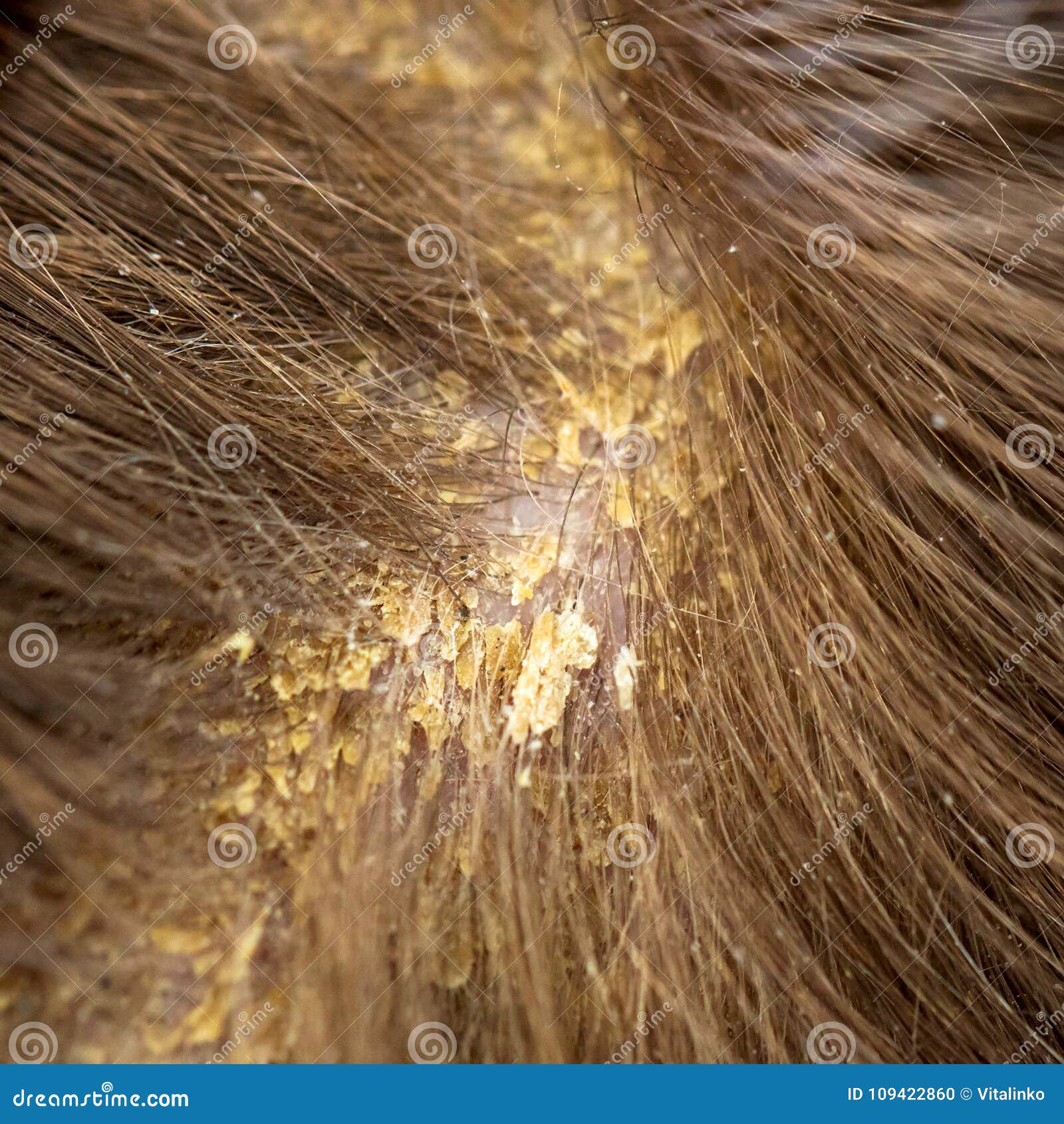 Forfora Nei Capelli Cuoio Capelluto a Fiocchi Seborrhea Fotografia ...