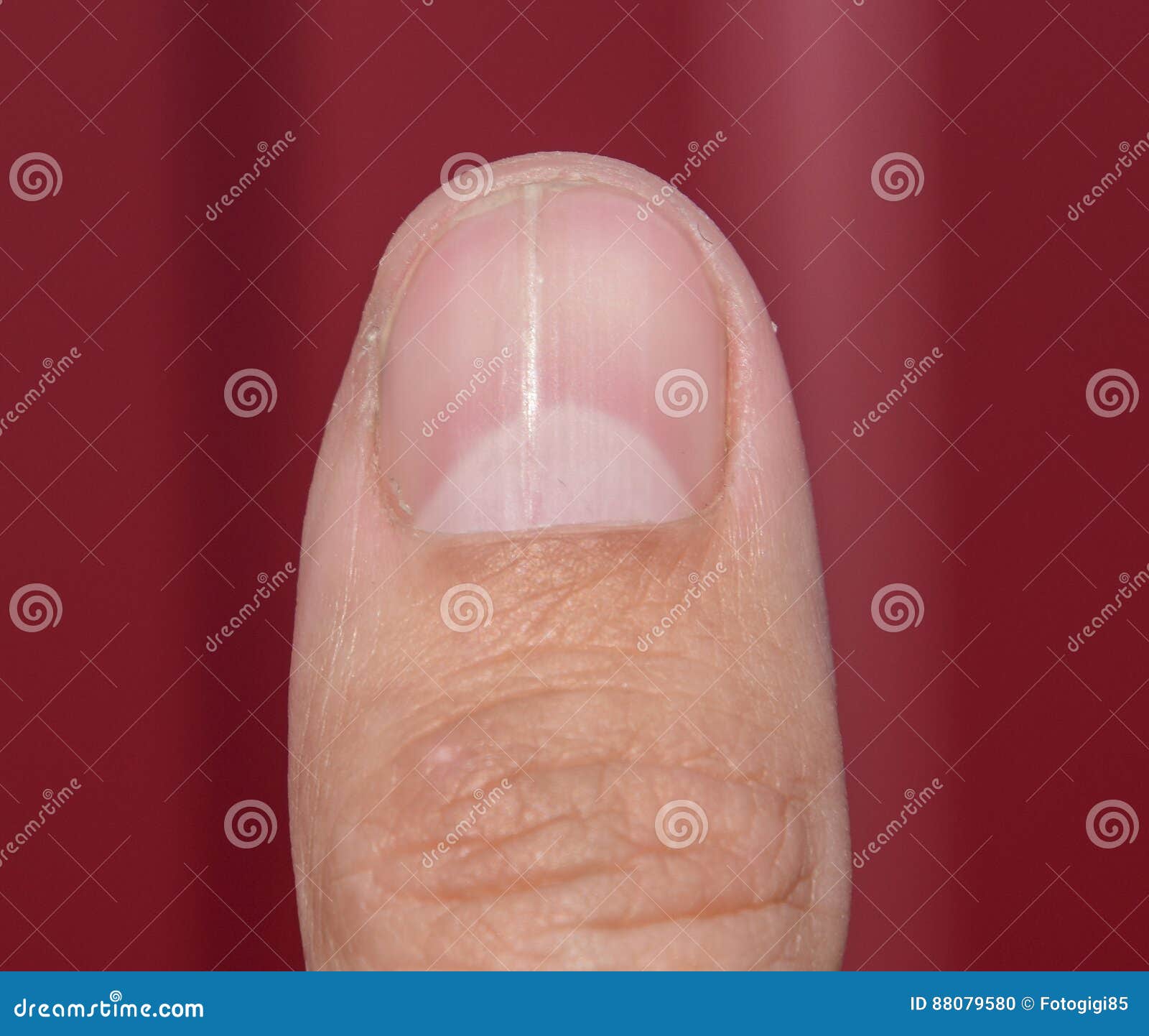 Forked Nail on the Thumb. Dilation of the Nail, Traumatic Pathology ...