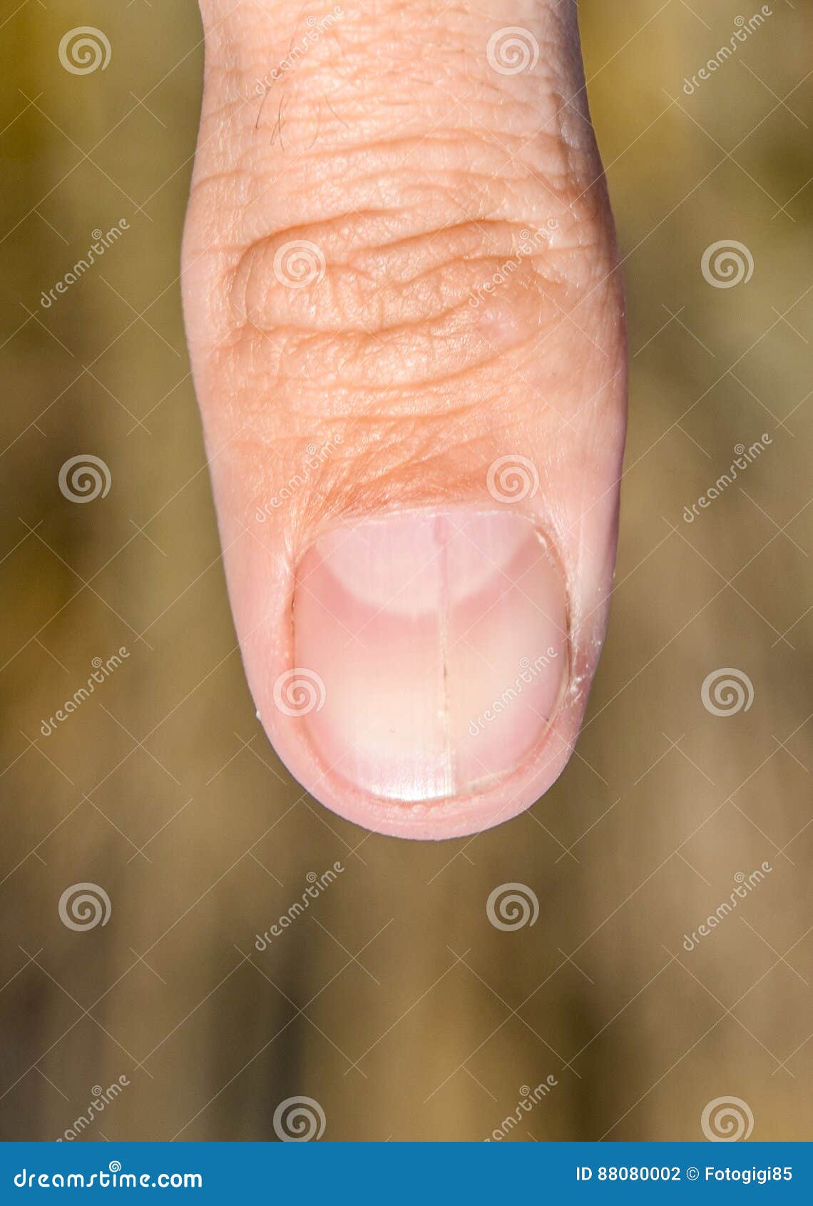 Forked Nail on the Thumb. Dilation of the Nail, Traumatic Pathology ...