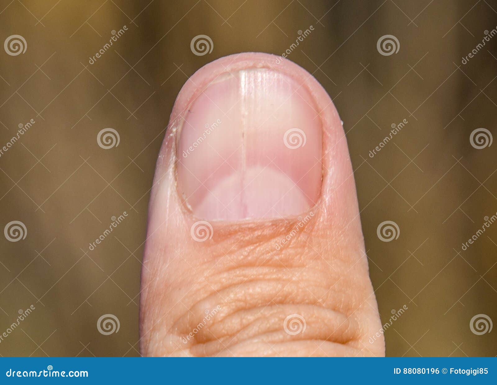 Forked Nail on the Thumb. Dilation of the Nail, Traumatic Pathology ...