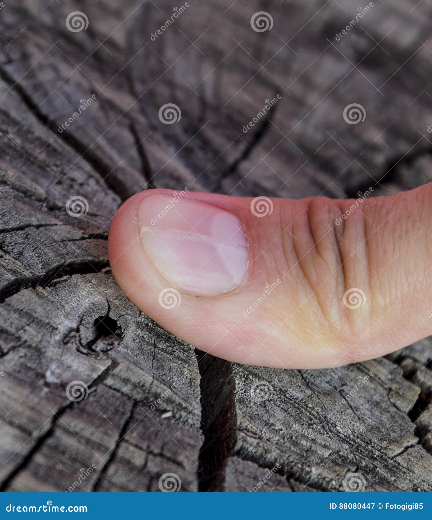 Forked Nail on the Thumb. Dilation of the Nail, Traumatic Pathology ...