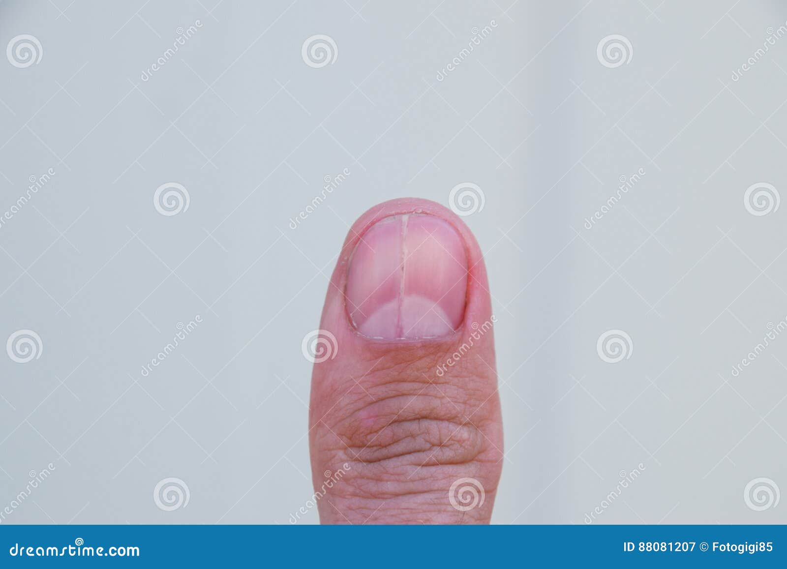 Forked Nail on the Thumb. Dilation of the Nail, Traumatic Pathology ...