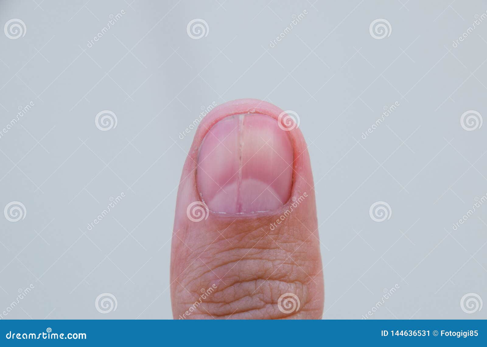 Forked Nail on the Thumb. Dilation of the Nail, Traumatic Pathology ...