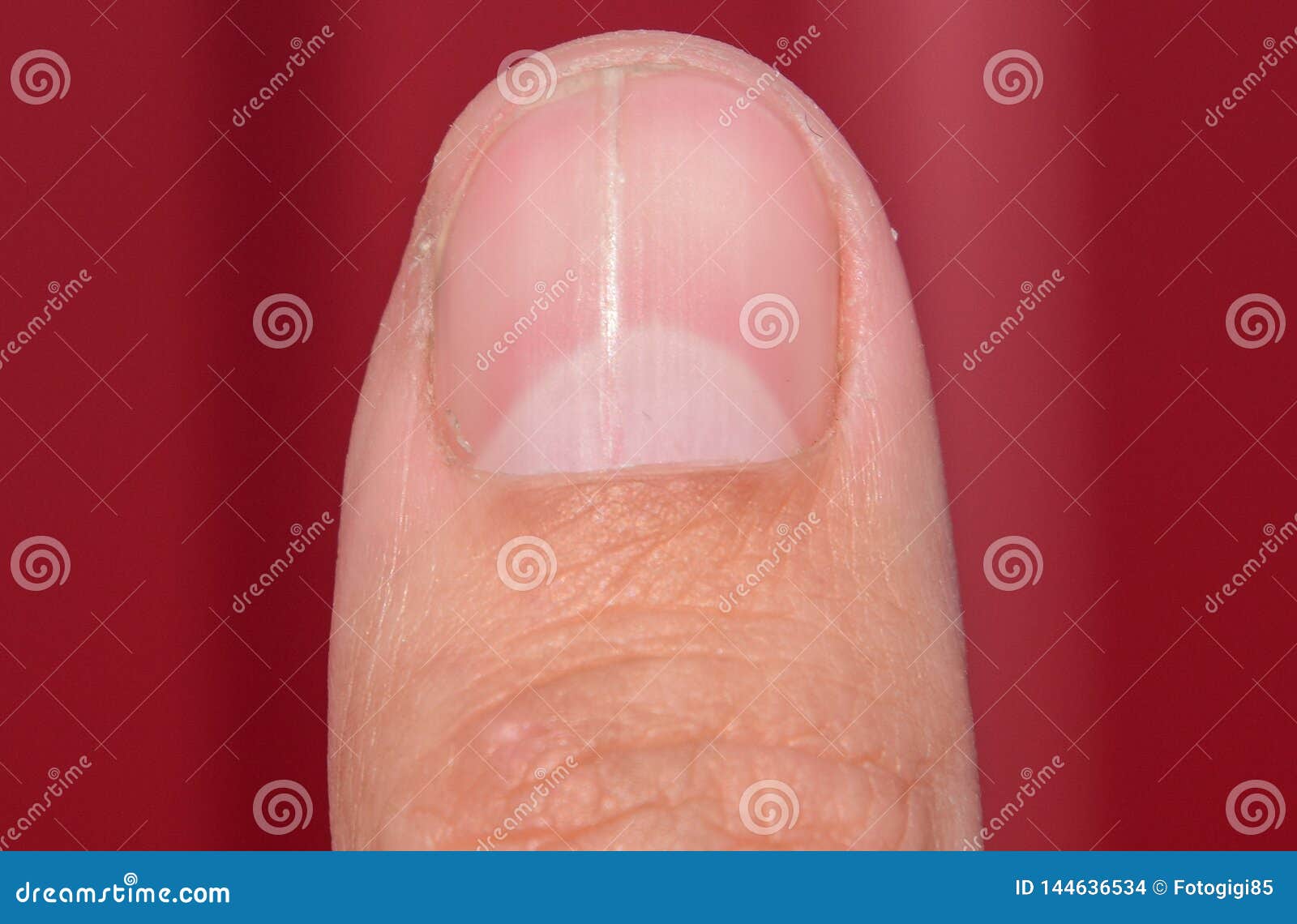 Forked Nail on the Thumb. Dilation of the Nail, Traumatic Pathology ...