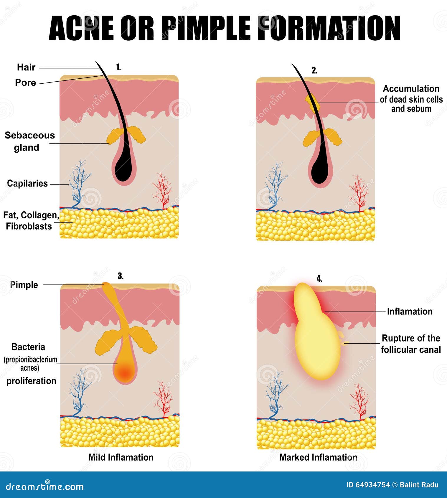 Formação De Acne Ou De Espinha Da Pele Ilustração do Vetor - Ilustração ...