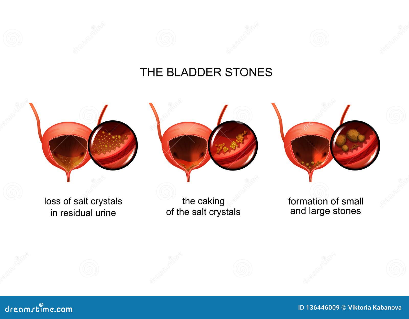 Bladder Stones. Cross Section Royalty-Free Illustration | CartoonDealer ...