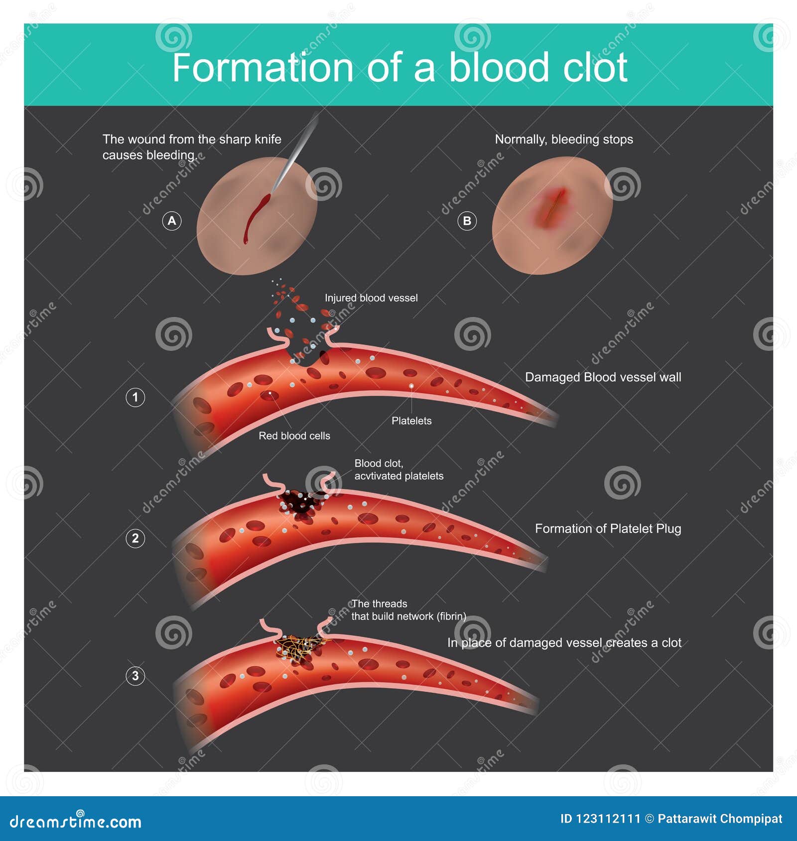 Formation D'un Caillot Sanguin Illustration Stock - Illustration du ...