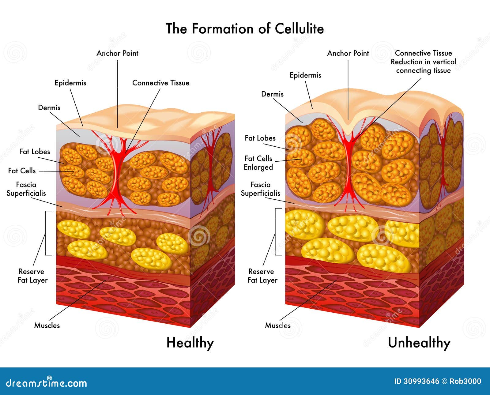Formation des cellulites illustration de vecteur. Illustration du tissu ...