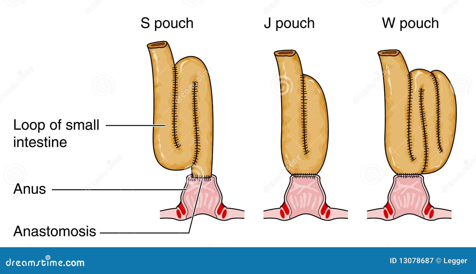 Loop Ileostomy J Pouch
