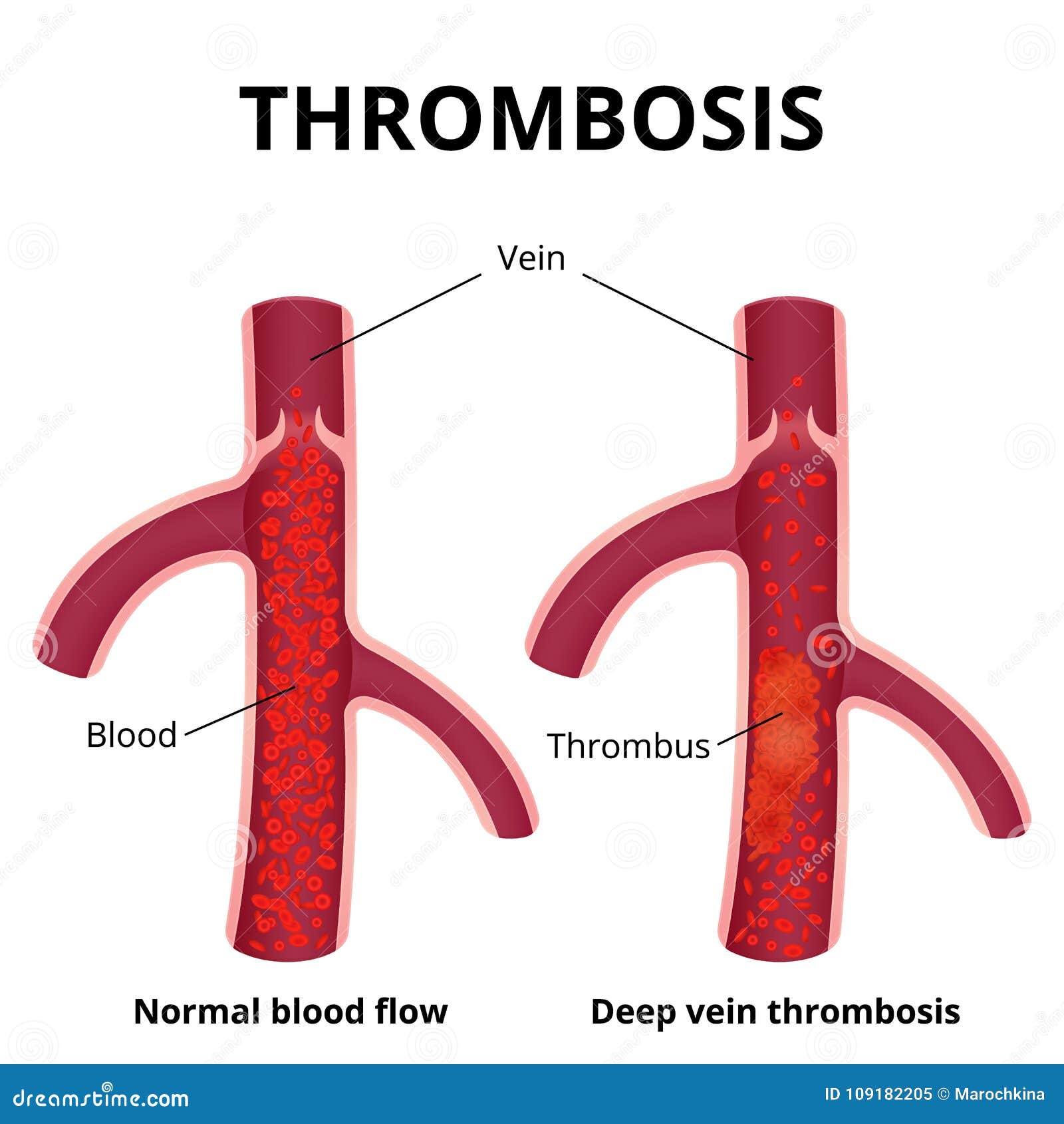 Formazione dell'embolo illustrazione vettoriale. Illustrazione di ...