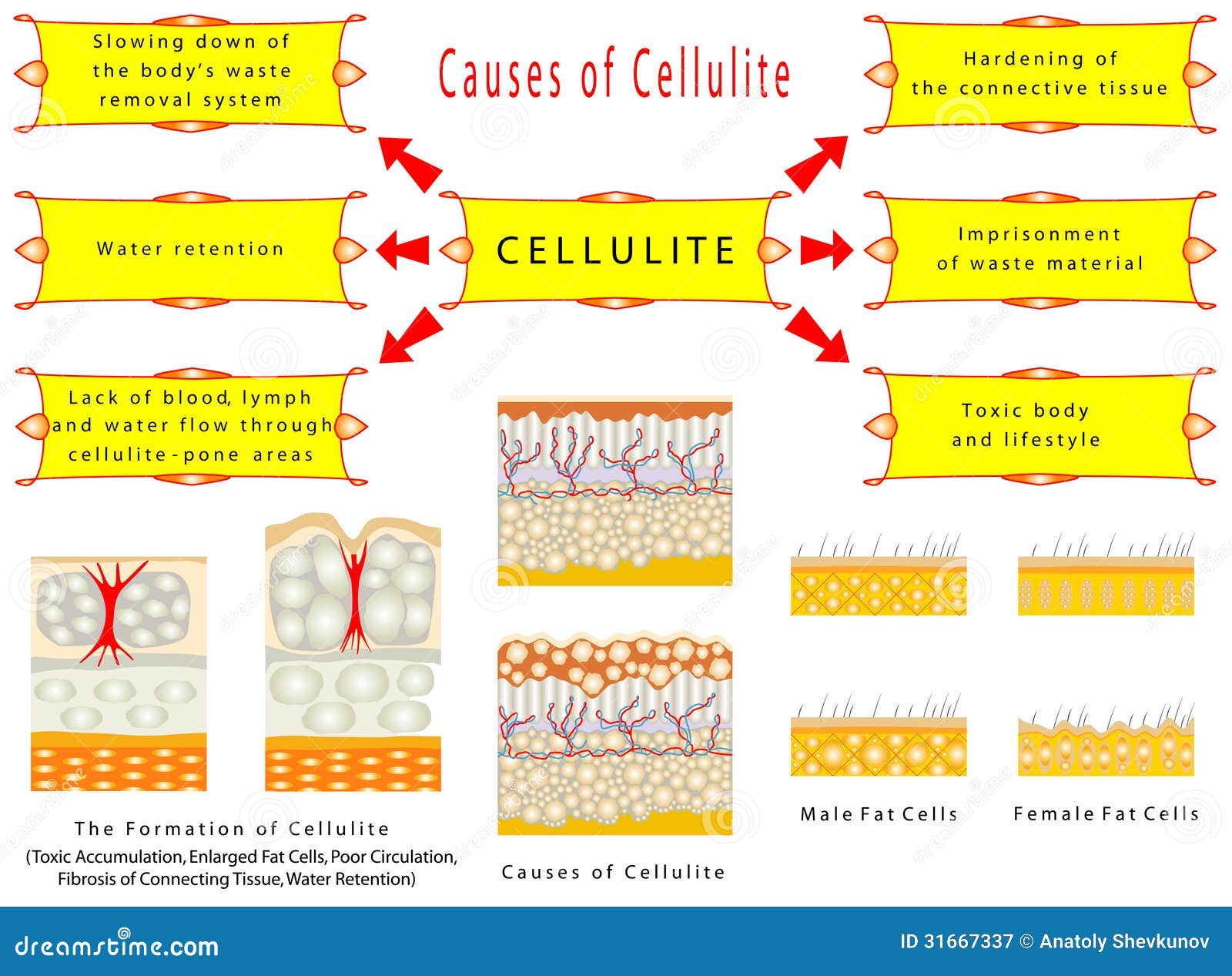 Formazione di celluliti illustrazione vettoriale. Illustrazione di ...