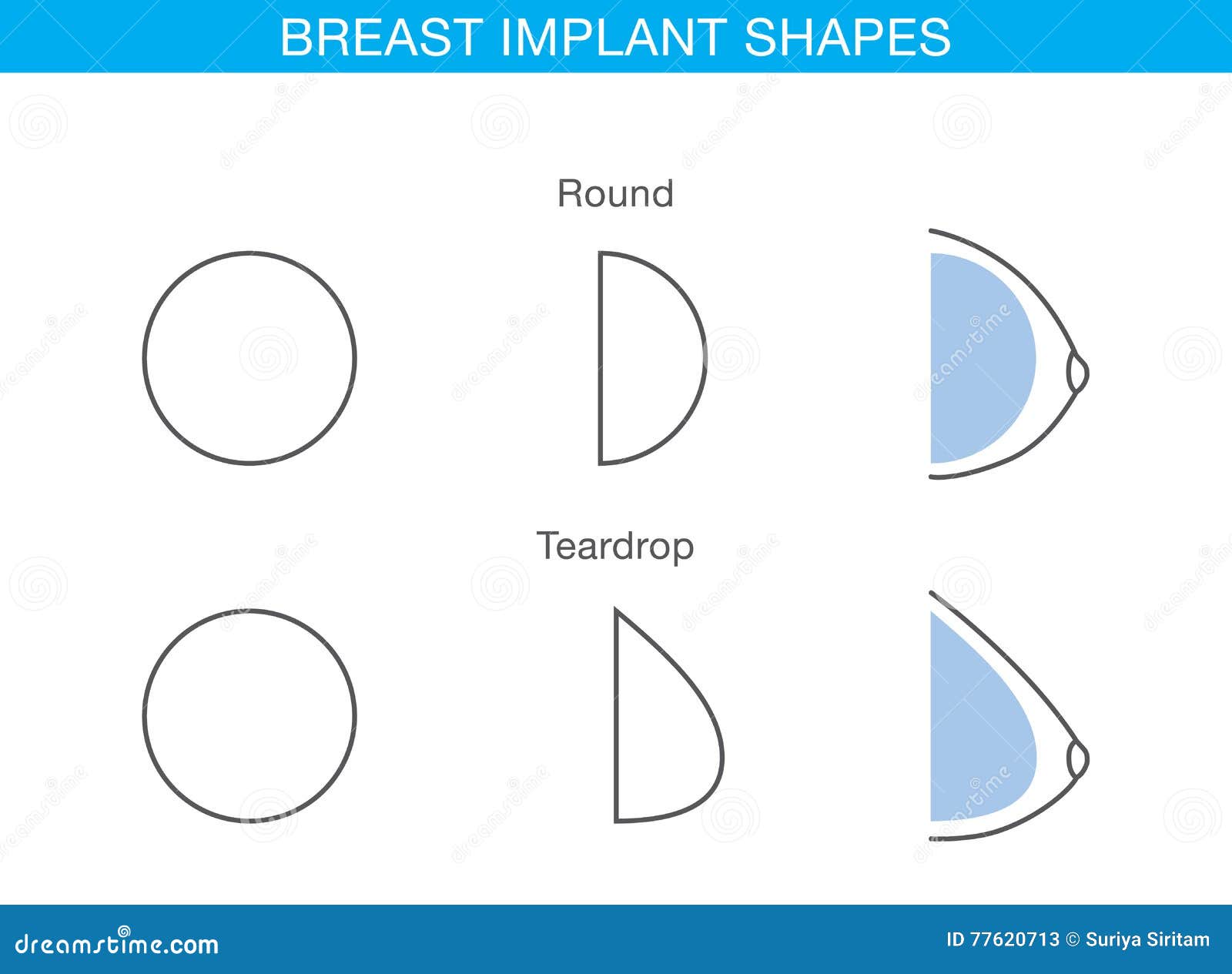 Forme Di Differenza Della Protesi Del Seno Illustrazione Vettoriale ...