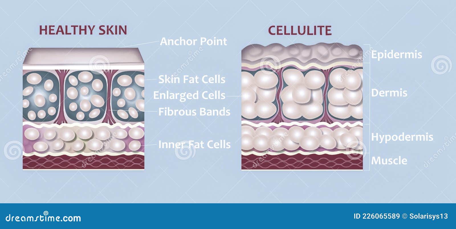 Forming of Underskin Cellulite Illustration Stock Image - Image of ...