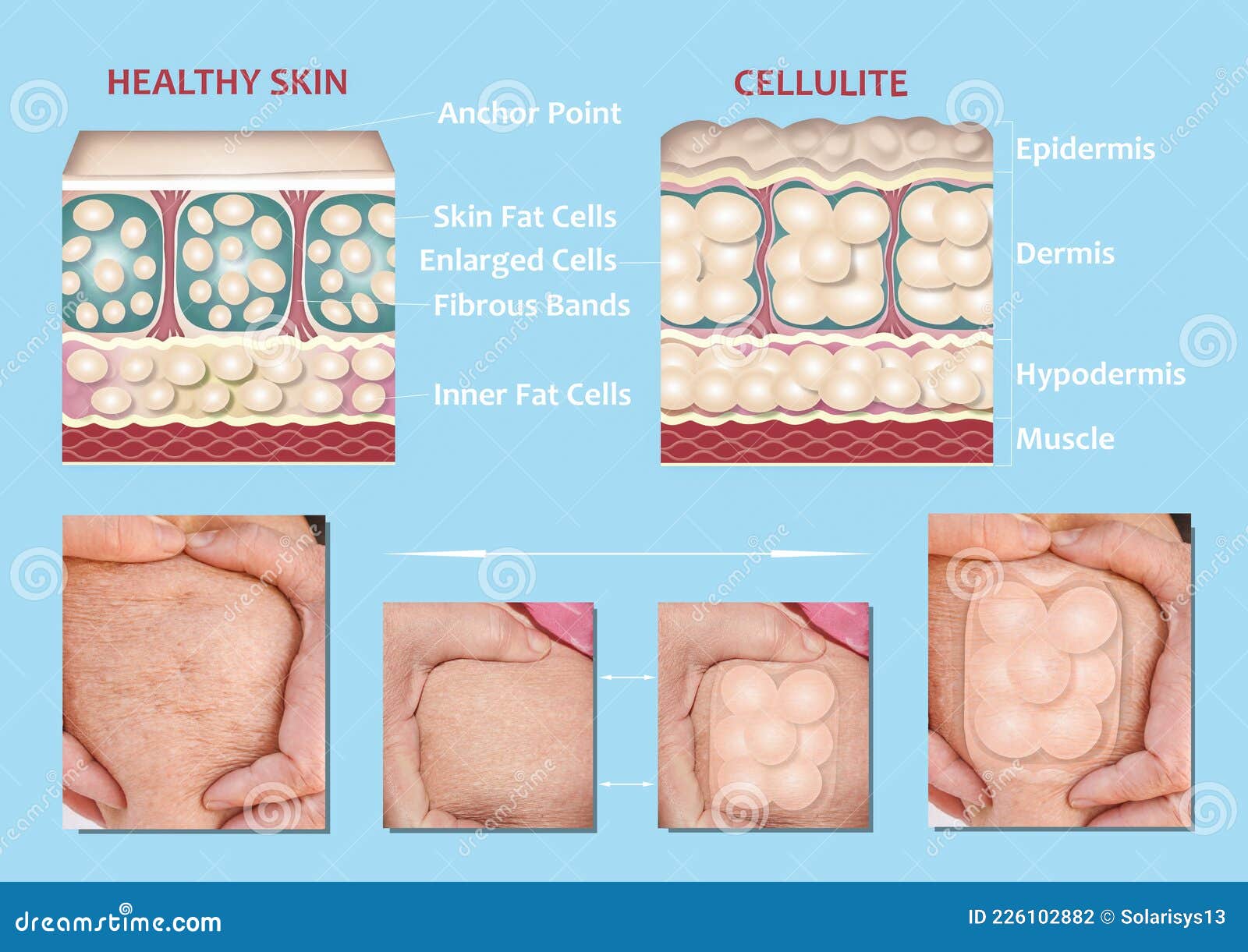 Forming of Underskin Cellulite Illustration Stock Illustration ...