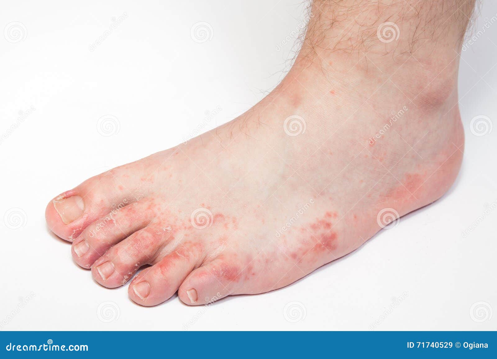 Fotsvampsvampar fotografering för bildbyråer. Bild av manlig - 71740529