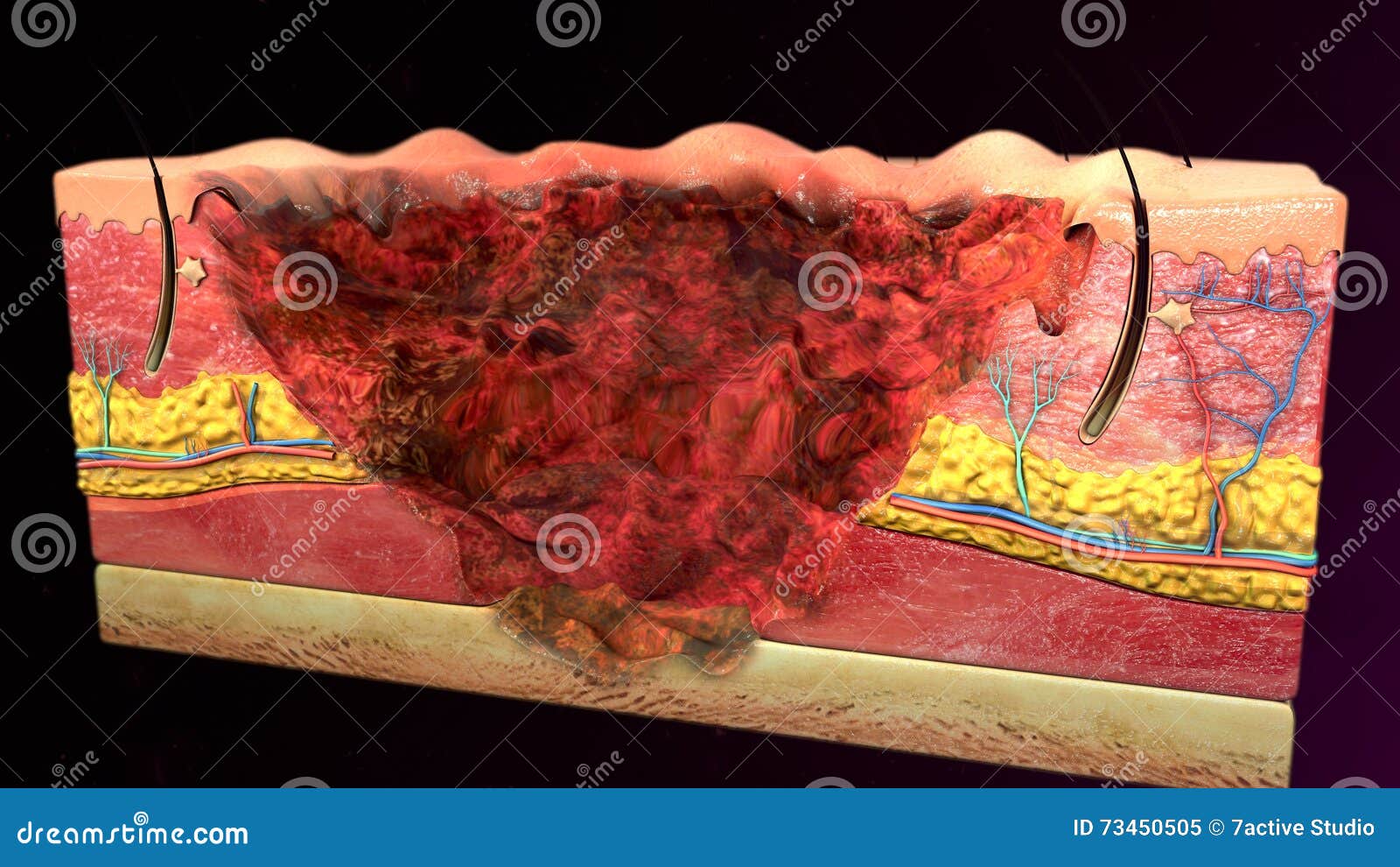 Fourth Degree Burns Stock Image Image Of Fourth Ectodermal 73450505