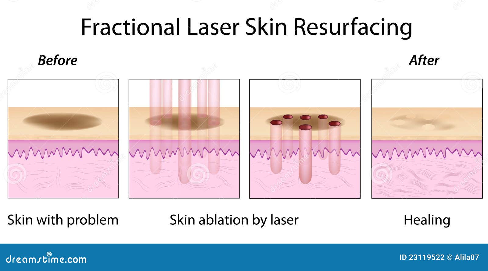 Fractional Laser Skin Resurfacing Stock Vector - Illustration of ...